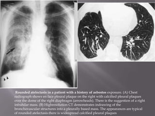Collapse- RADIOLOGY | PPTX