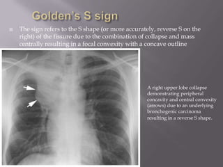 Collapsed Lung X Ray