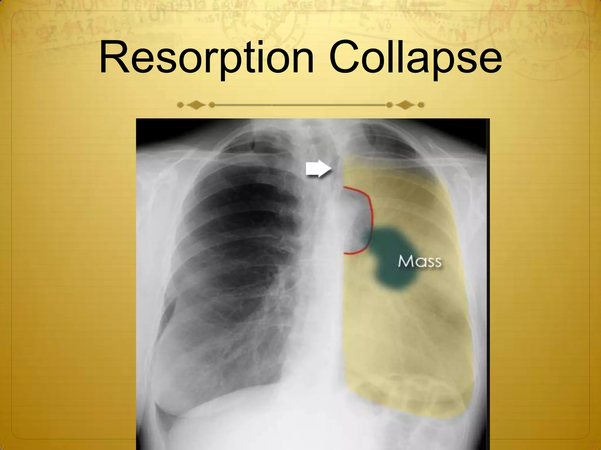 Collapse & consolidation made simple - chest X-rayz | PPTX