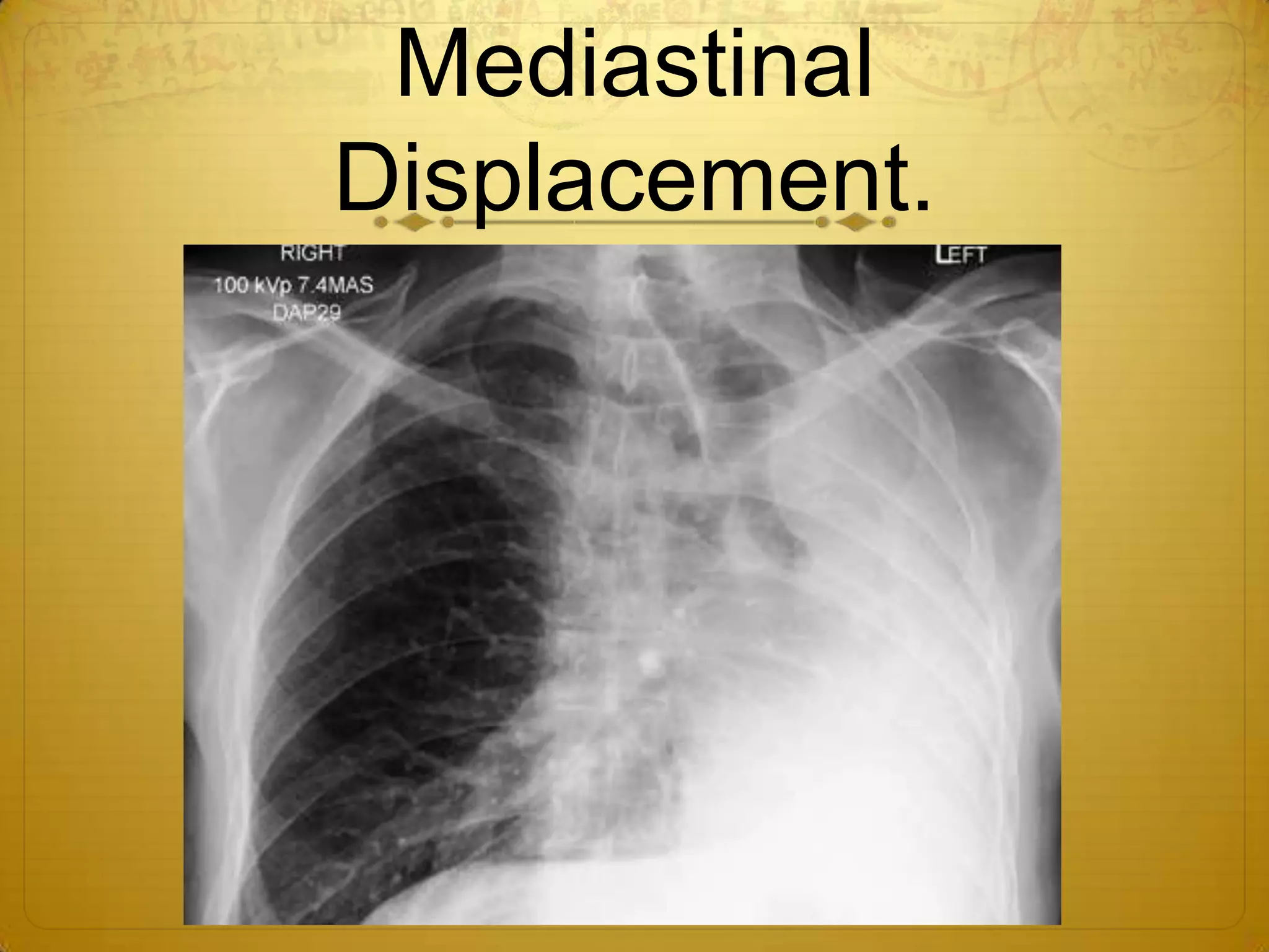 Collapse & consolidation made simple - chest X-rayz | PPTX