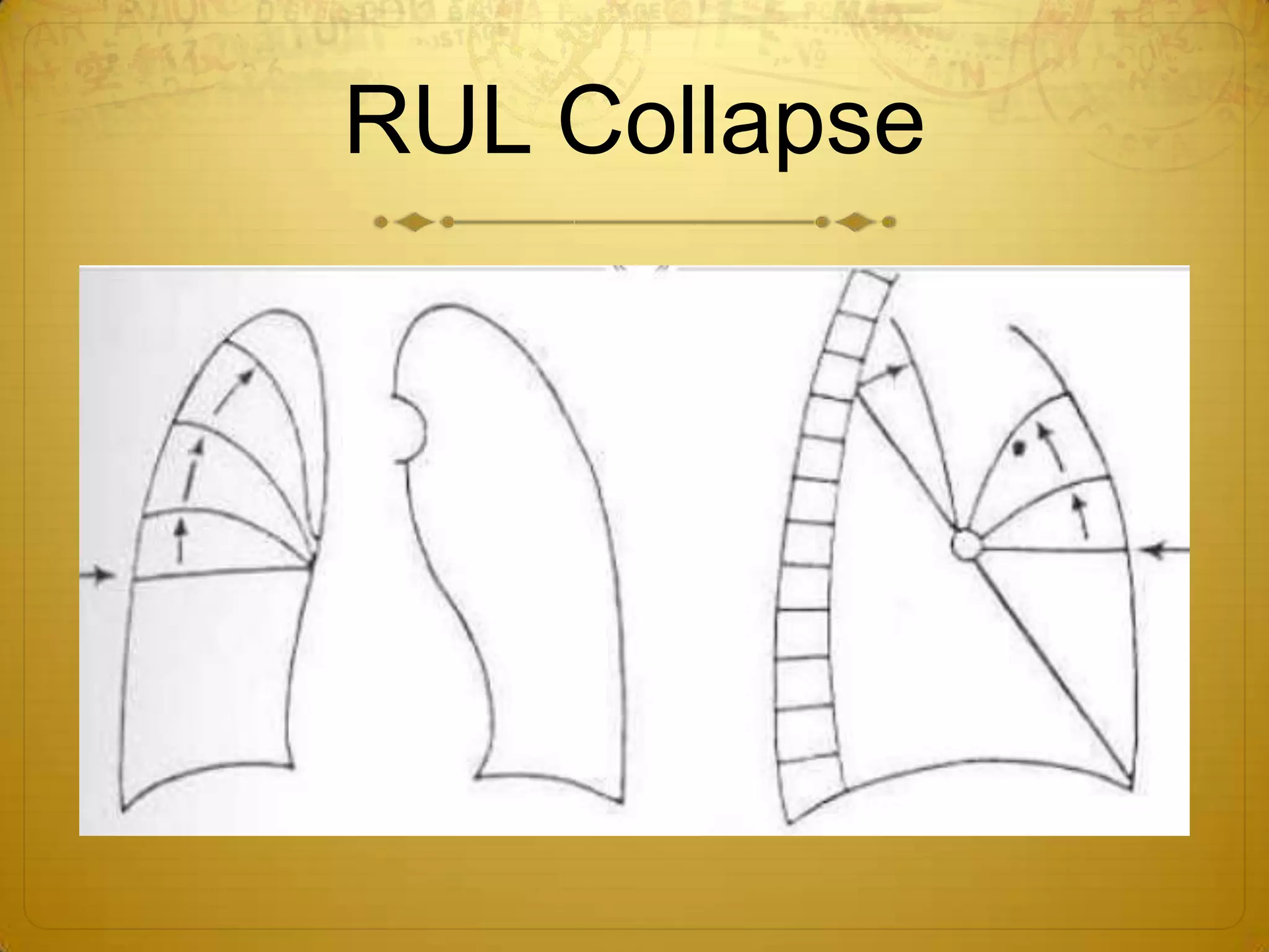 Collapse & consolidation made simple - chest X-rayz | PPTX