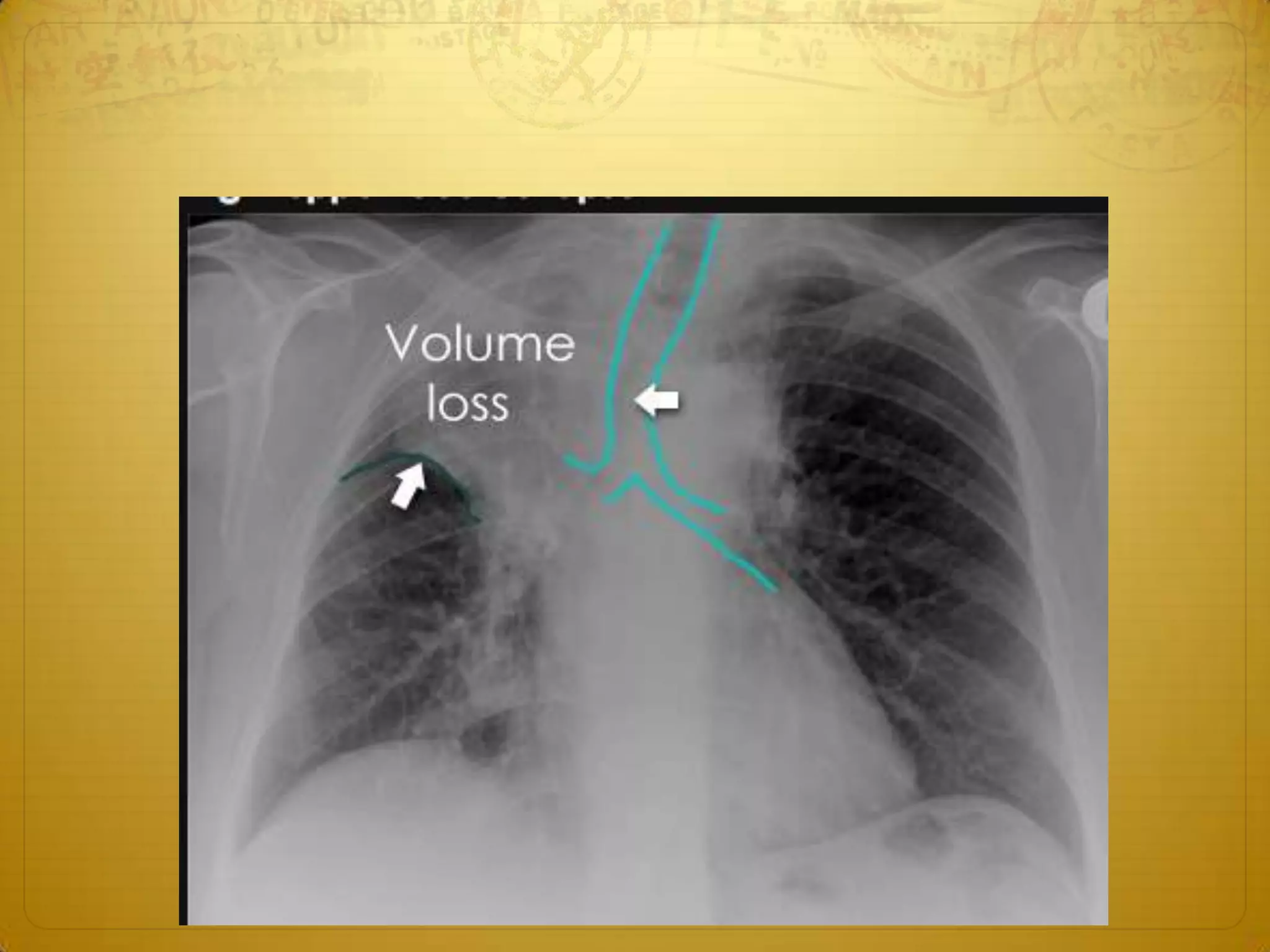 Collapse & consolidation made simple - chest X-rayz | PPTX