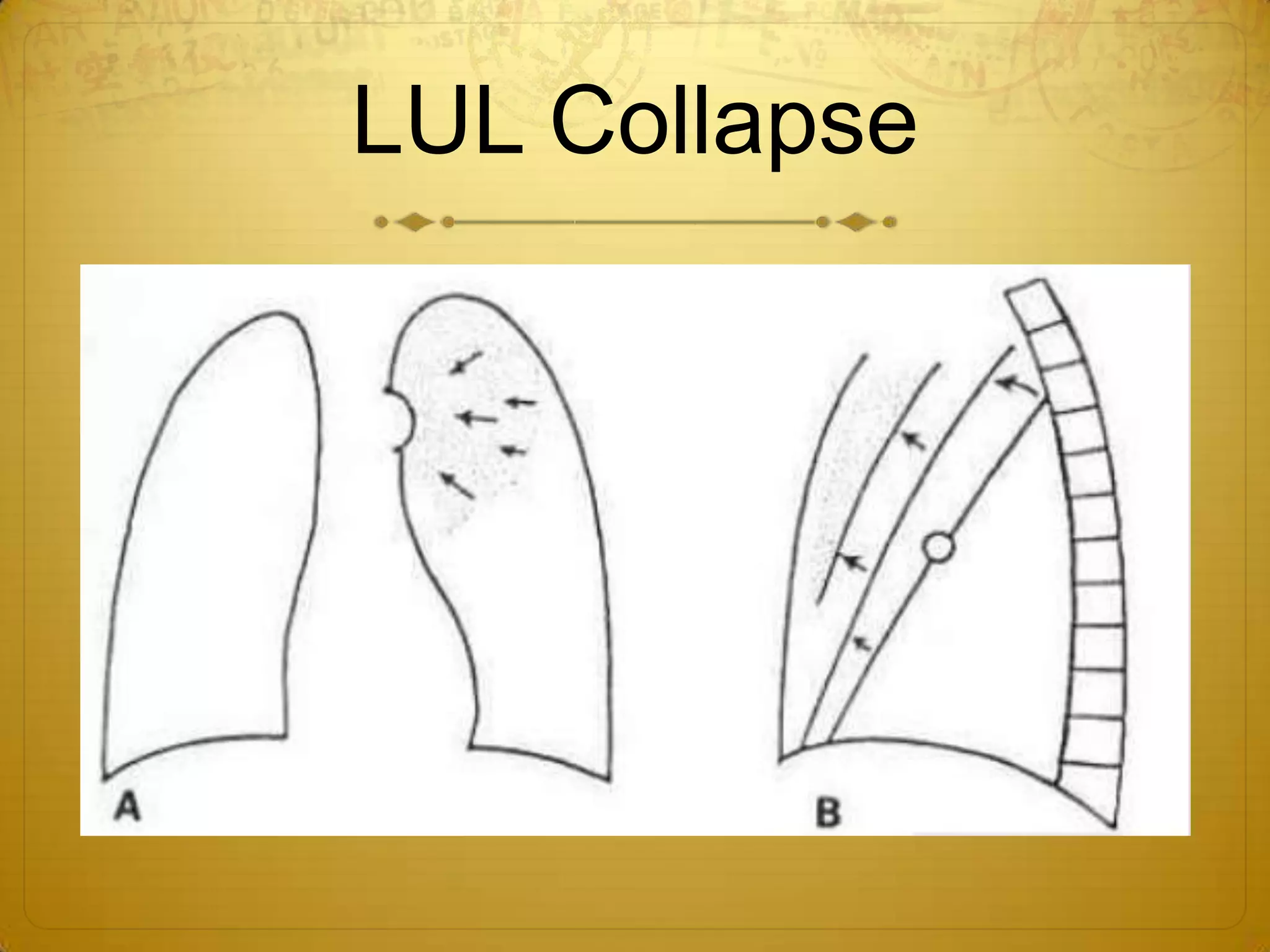 Collapse & consolidation made simple - chest X-rayz | PPTX