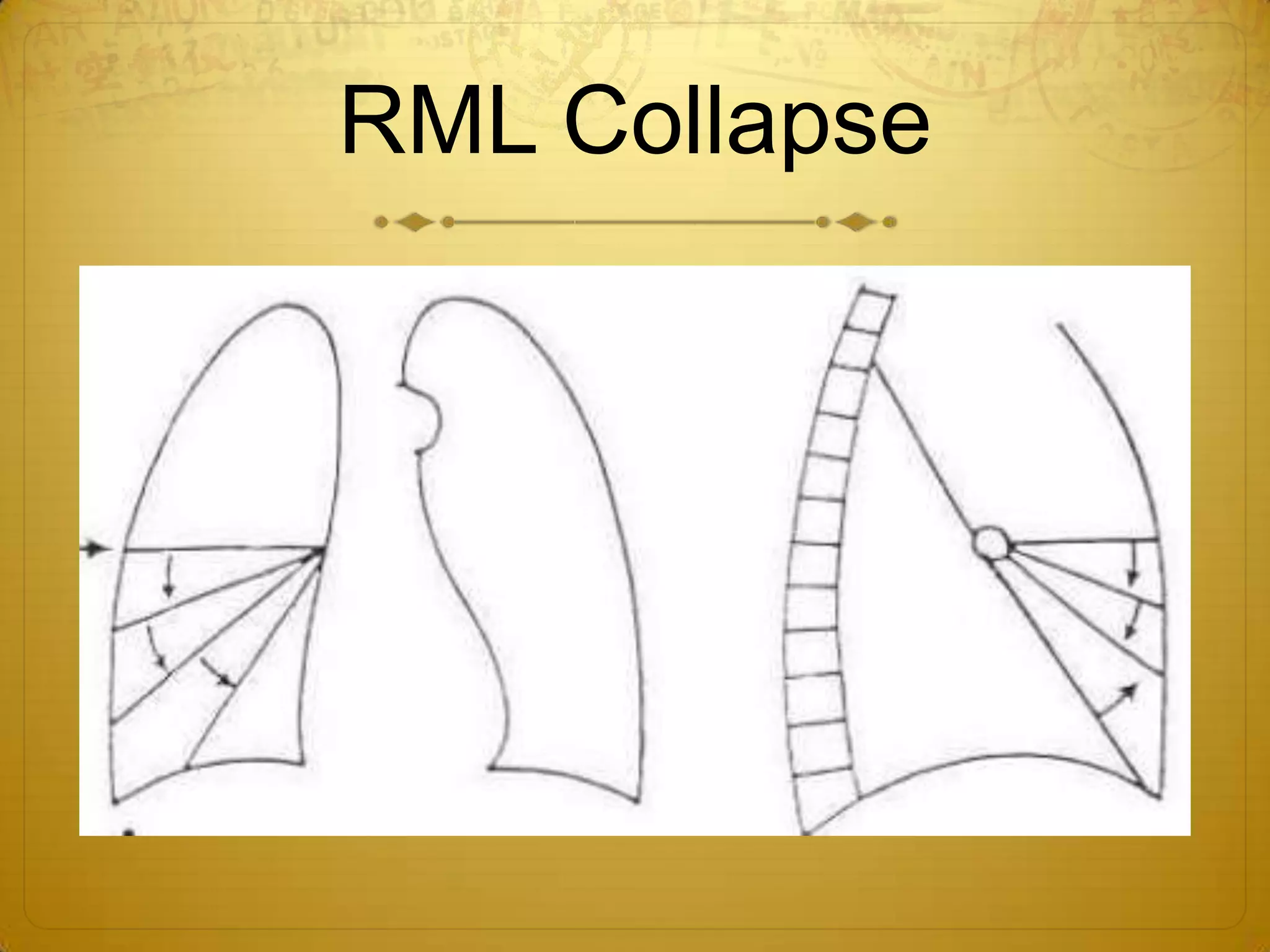 Collapse & consolidation made simple - chest X-rayz | PPTX