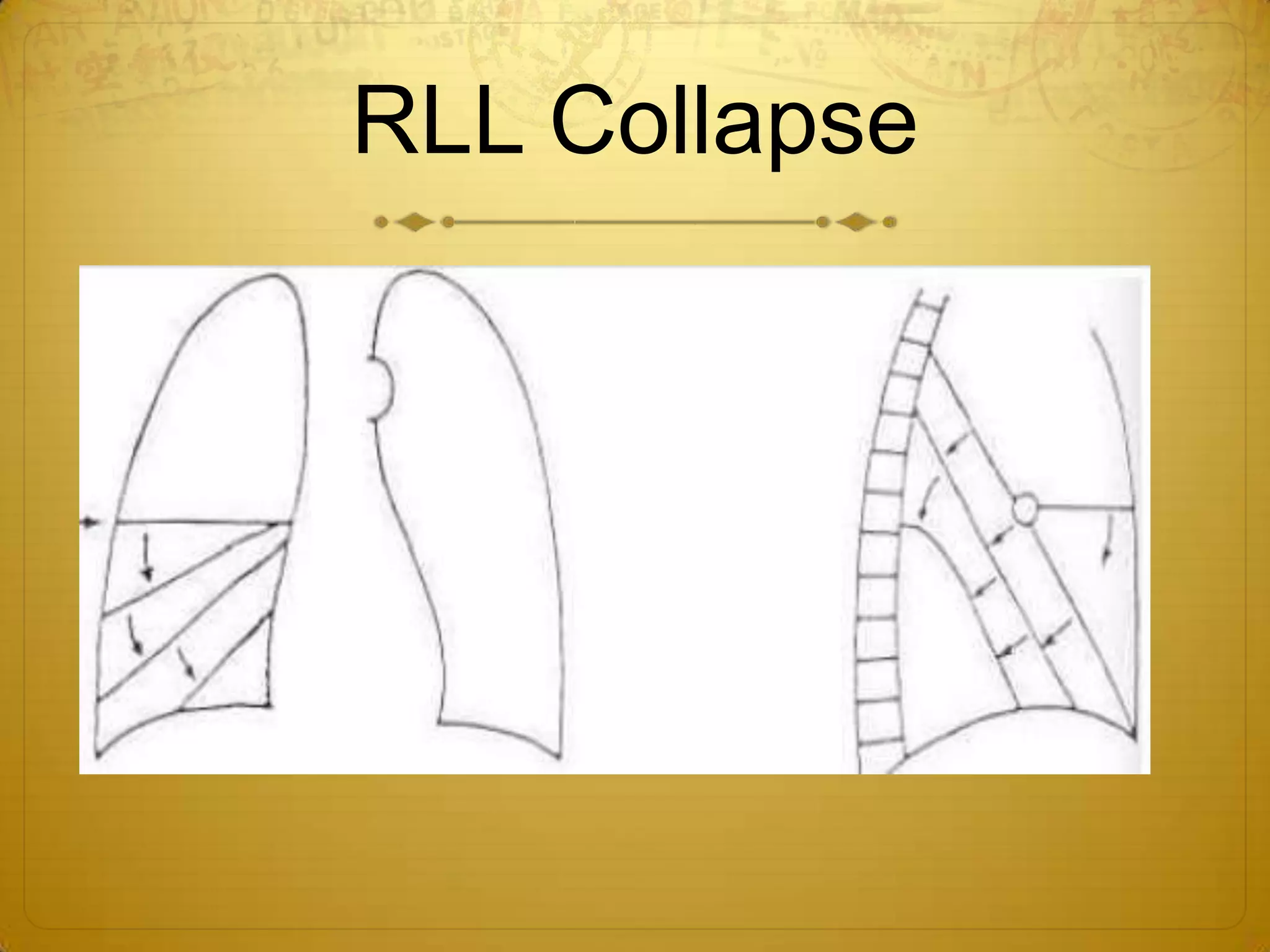 Collapse & consolidation made simple - chest X-rayz | PPTX