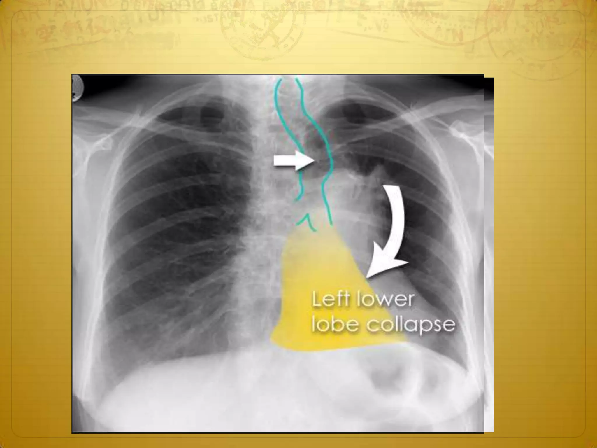 Collapse & consolidation made simple - chest X-rayz | PPTX