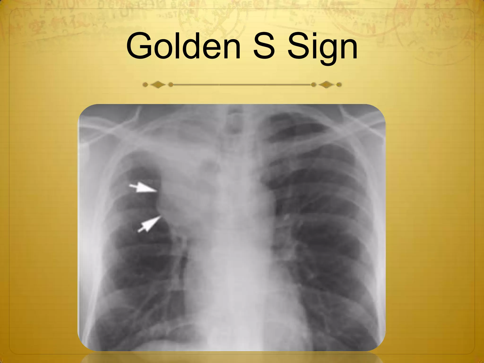 Collapse & consolidation made simple - chest X-rayz | PPTX