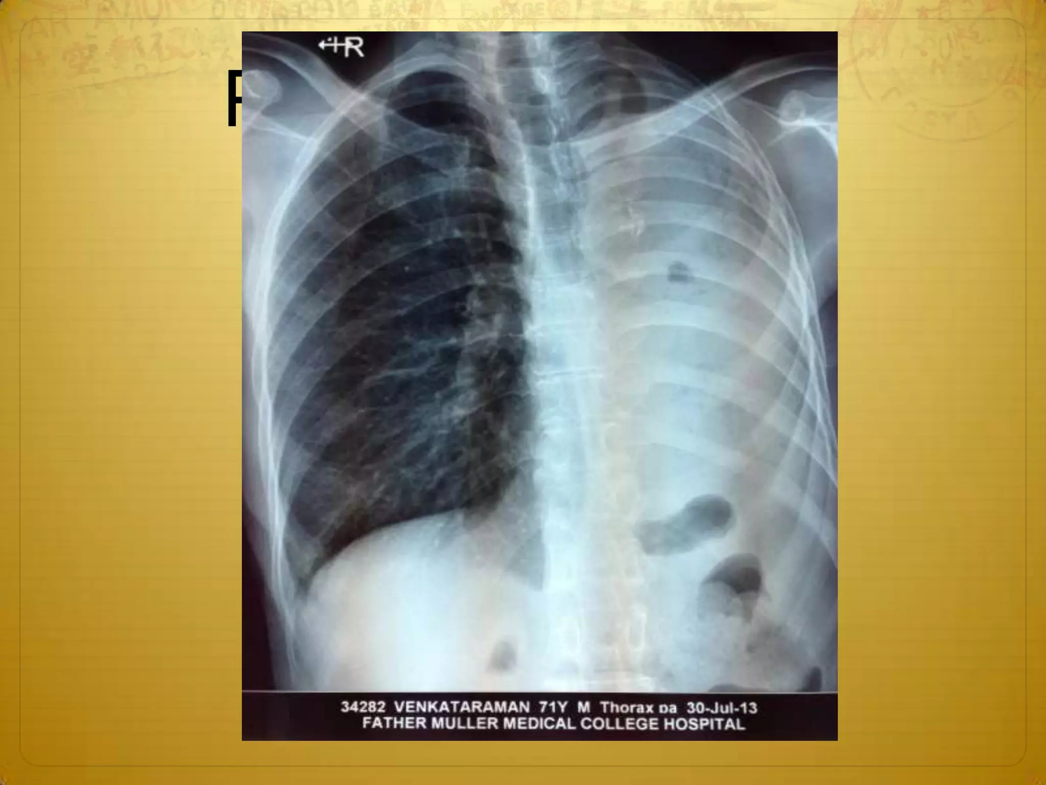 Collapse & consolidation made simple - chest X-rayz | PPTX