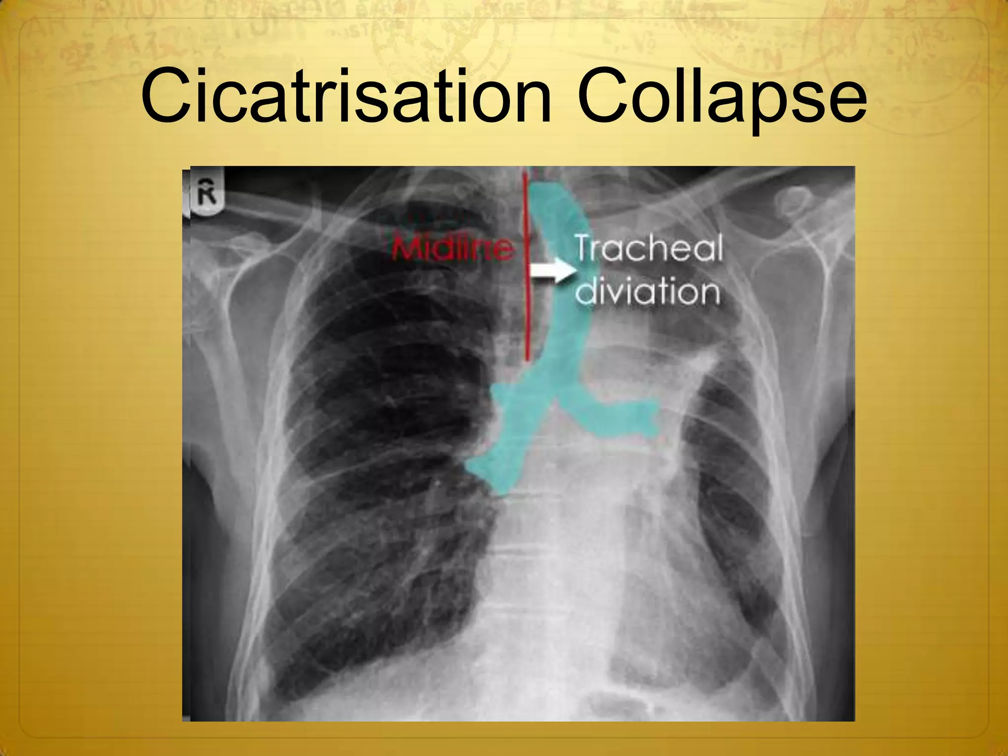 Collapse & consolidation made simple - chest X-rayz | PPTX