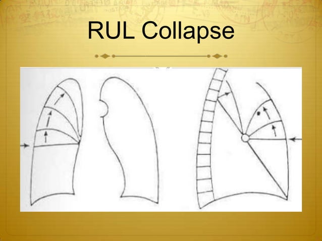 Collapse & consolidation made simple - chest X-rayz | PPTX | Lung and ...