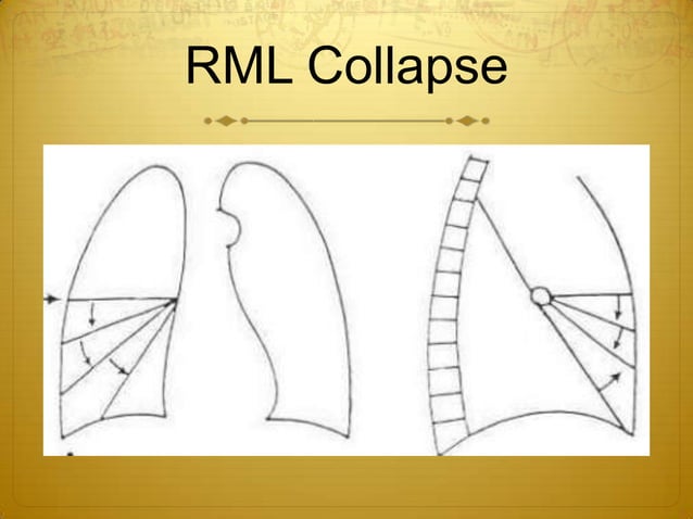 Collapse & consolidation made simple - chest X-rayz | PPTX | Lung and ...