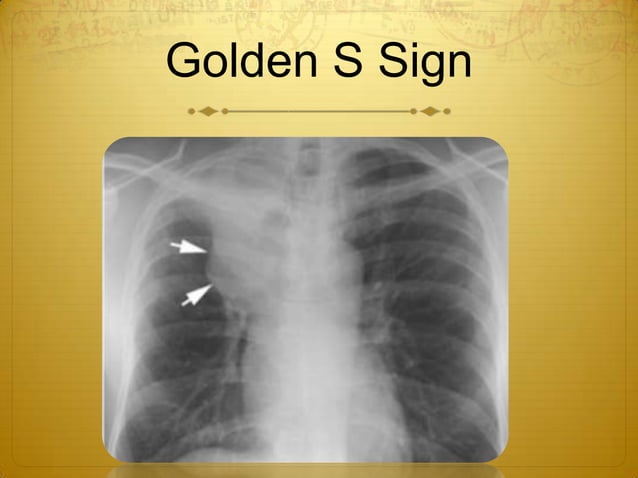 Collapse & consolidation made simple - chest X-rayz | PPTX | Lung and ...