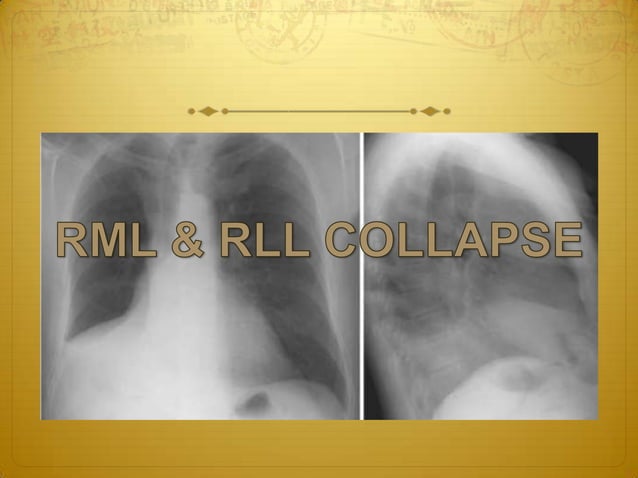 Collapse & consolidation made simple - chest X-rayz | PPTX | Lung and ...
