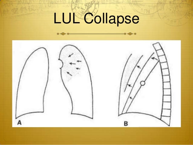 Collapse & consolidation made simple - chest X-rayz
