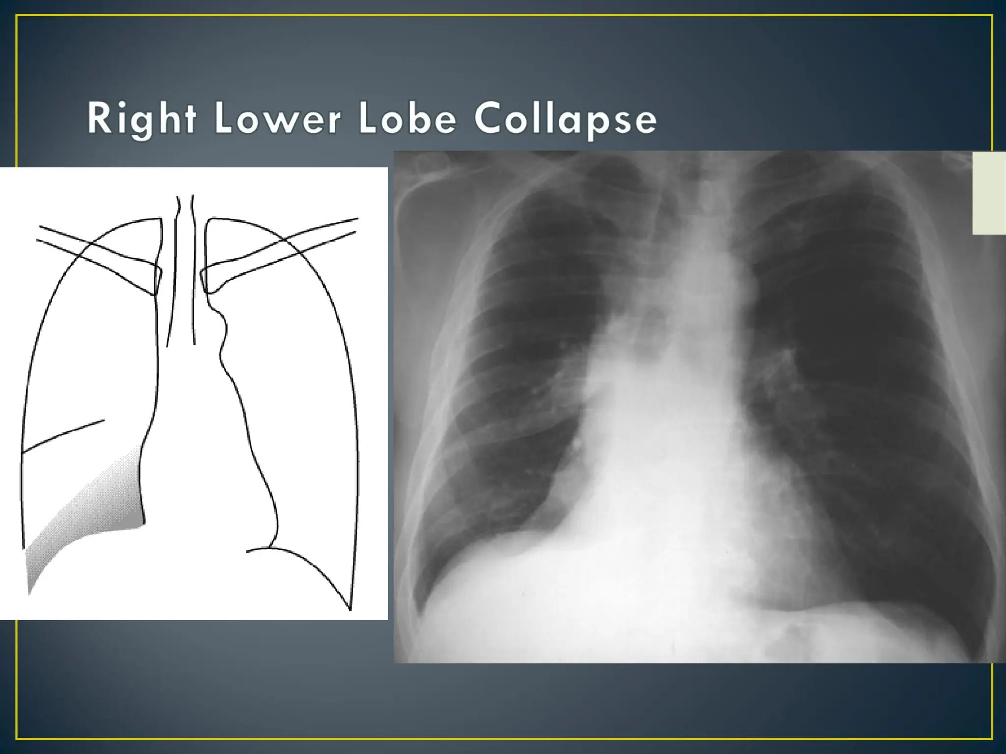 lung atelectasis presentation powerpoint .ppt
