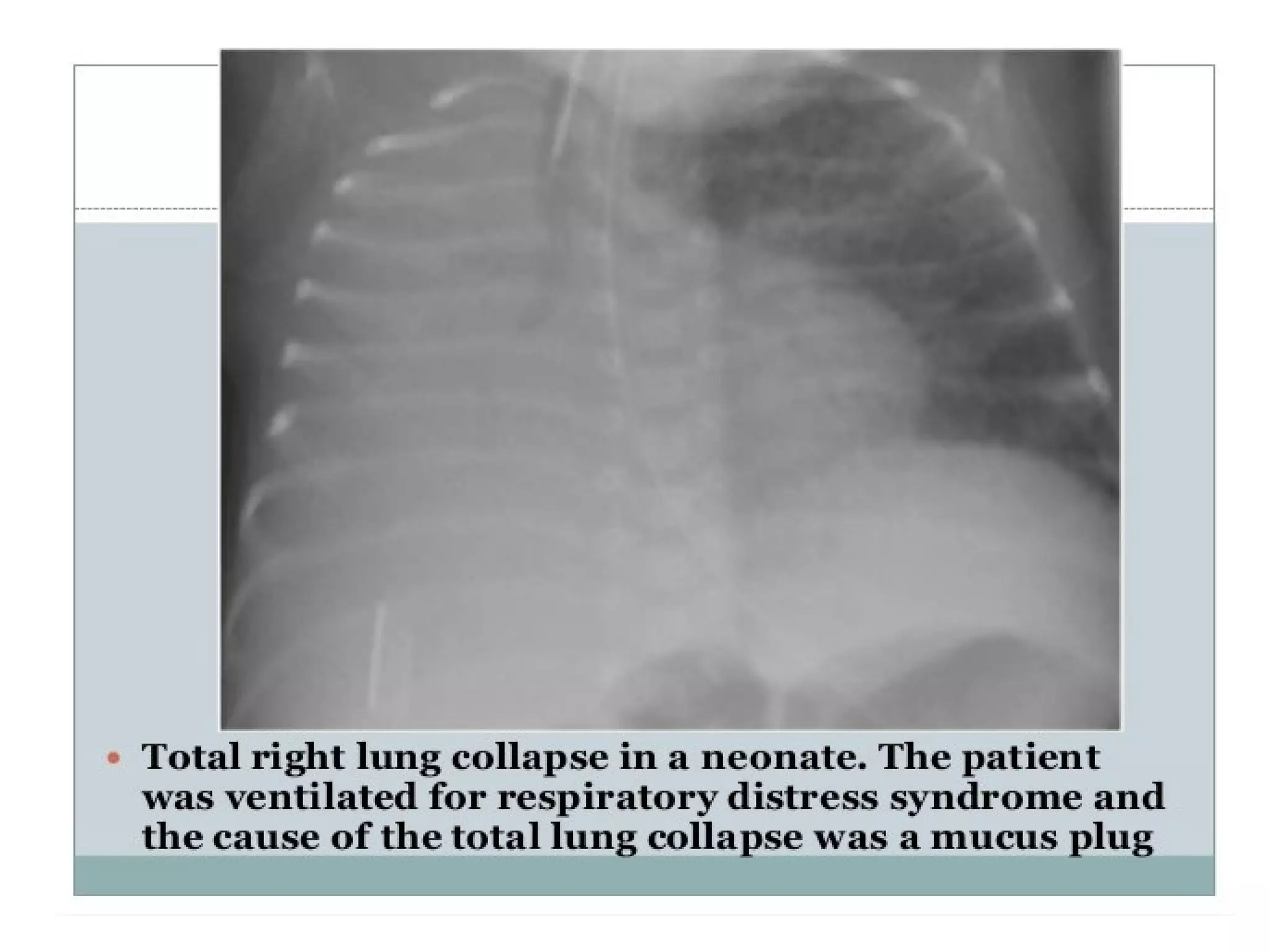 Collapse and consolidation Lung Radiology | PPT