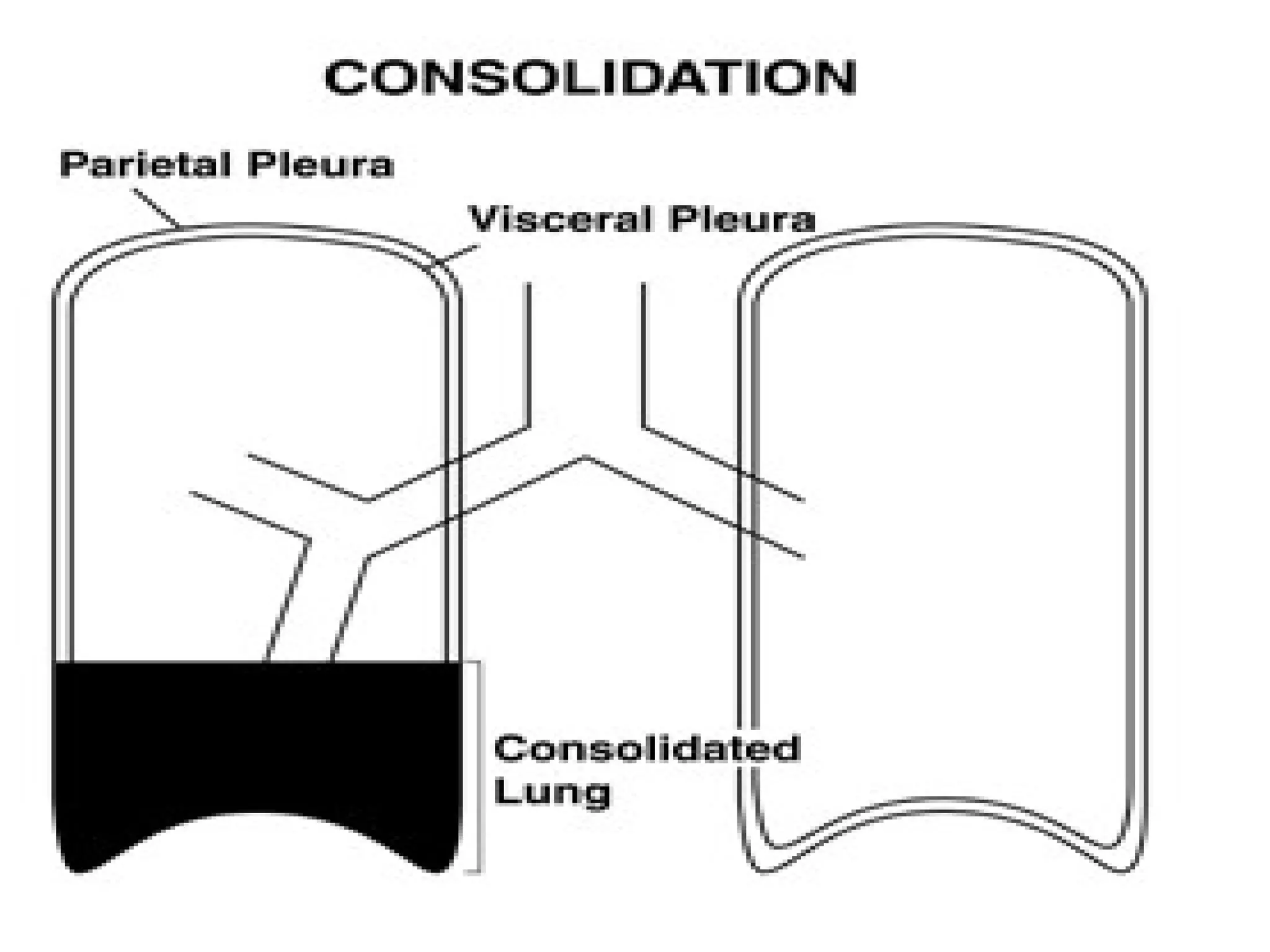 Collapse and consolidation Lung Radiology | PPT