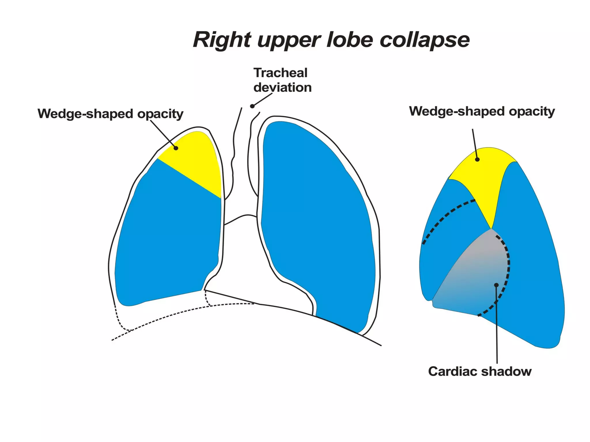 Collapse and consolidation Lung Radiology | PPT