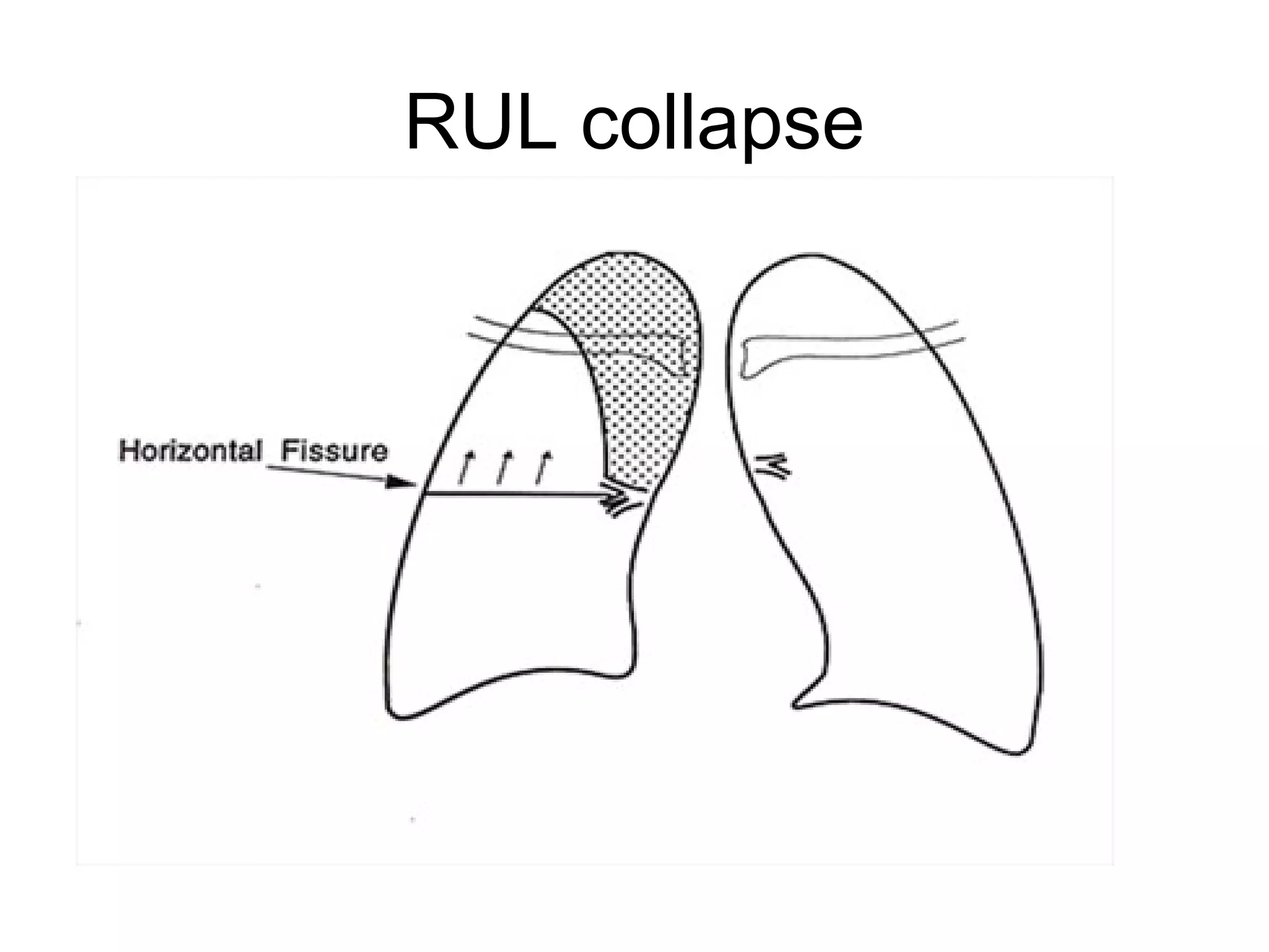 Collapse and consolidation Lung Radiology | PPT
