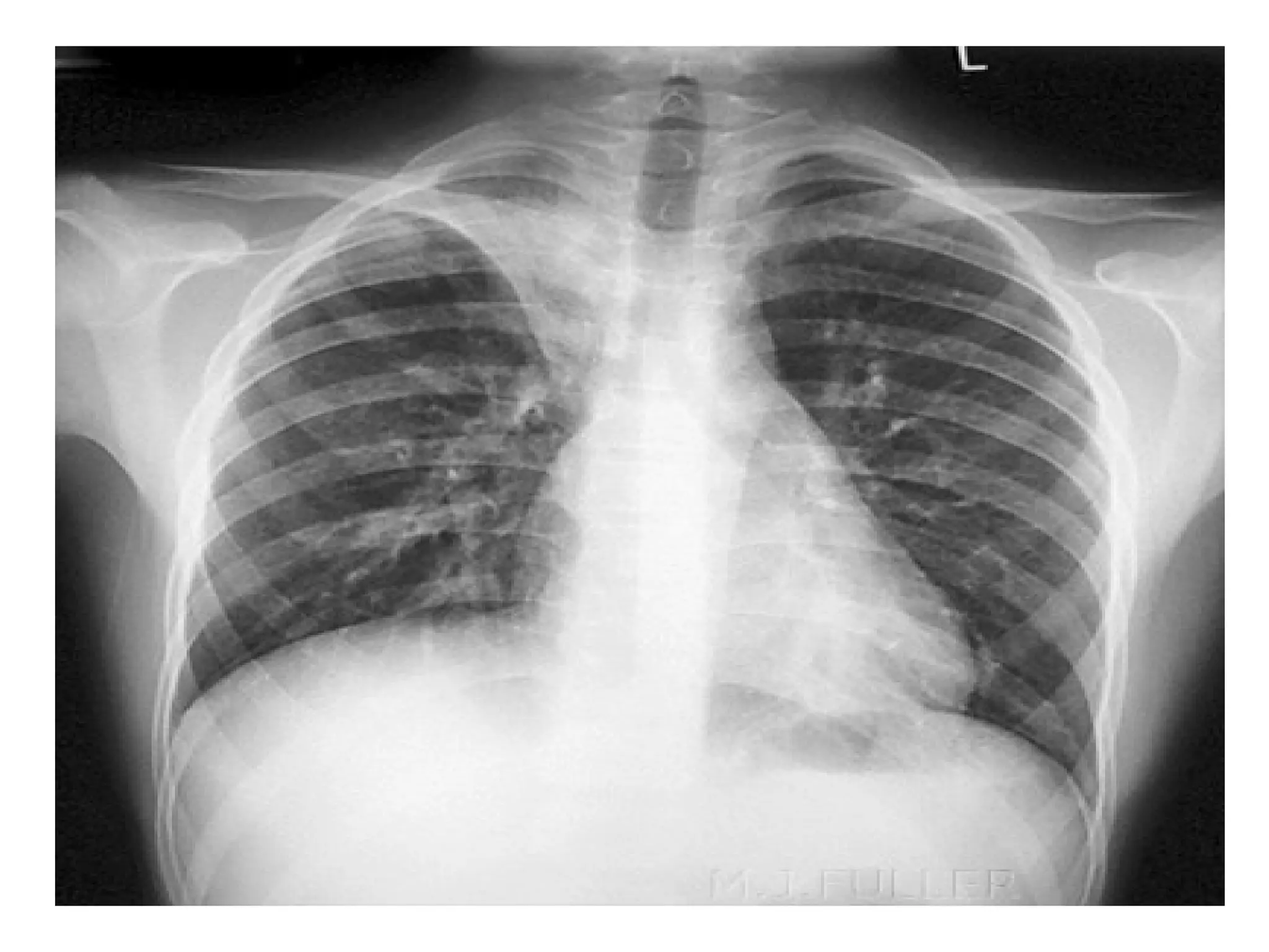 Collapse and consolidation Lung Radiology | PPT