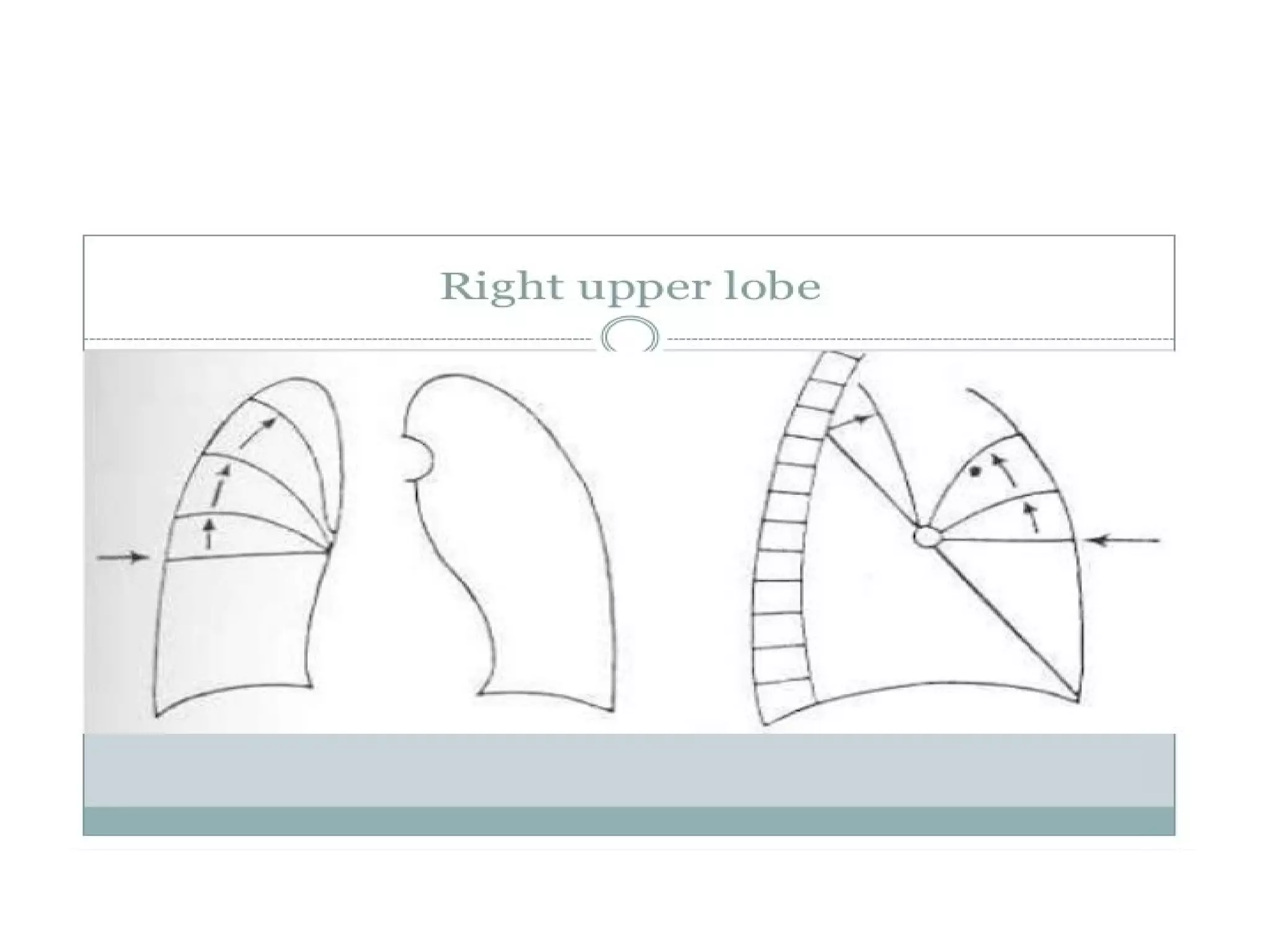 Collapse and consolidation Lung Radiology | PPT