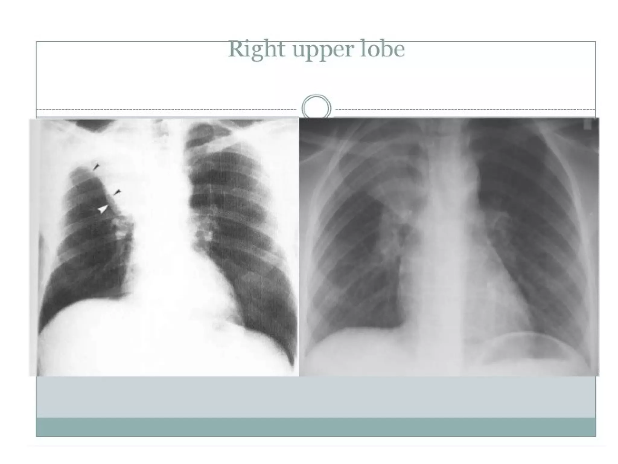 Collapse and consolidation Lung Radiology | PPT
