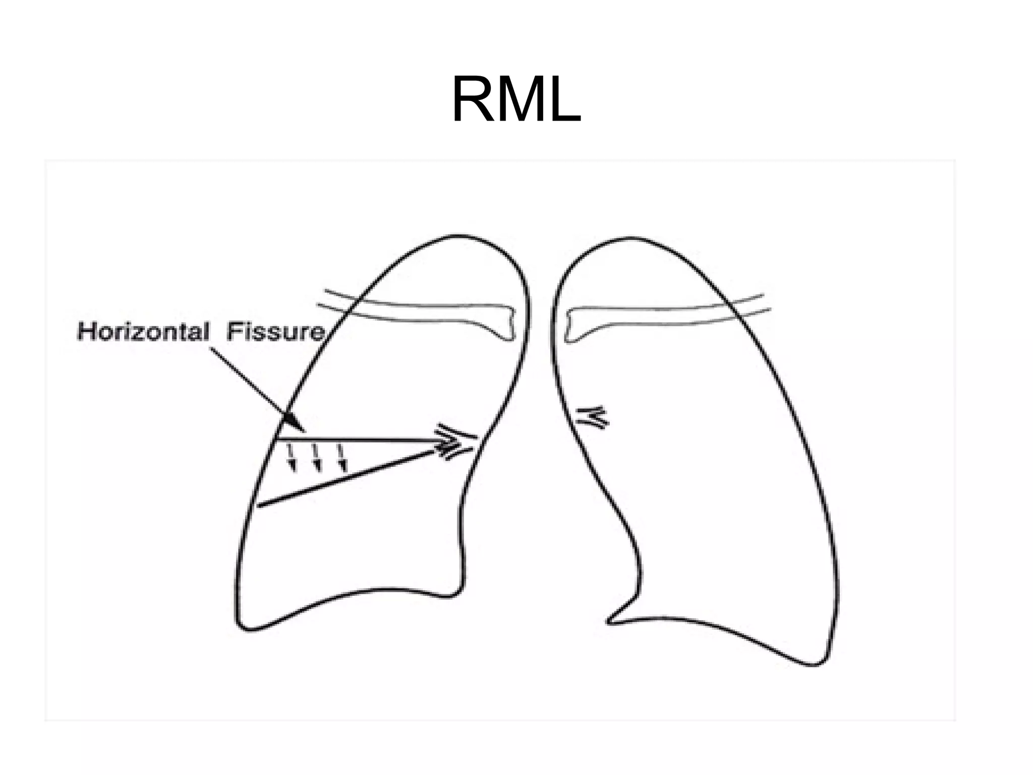Collapse and consolidation Lung Radiology | PPT