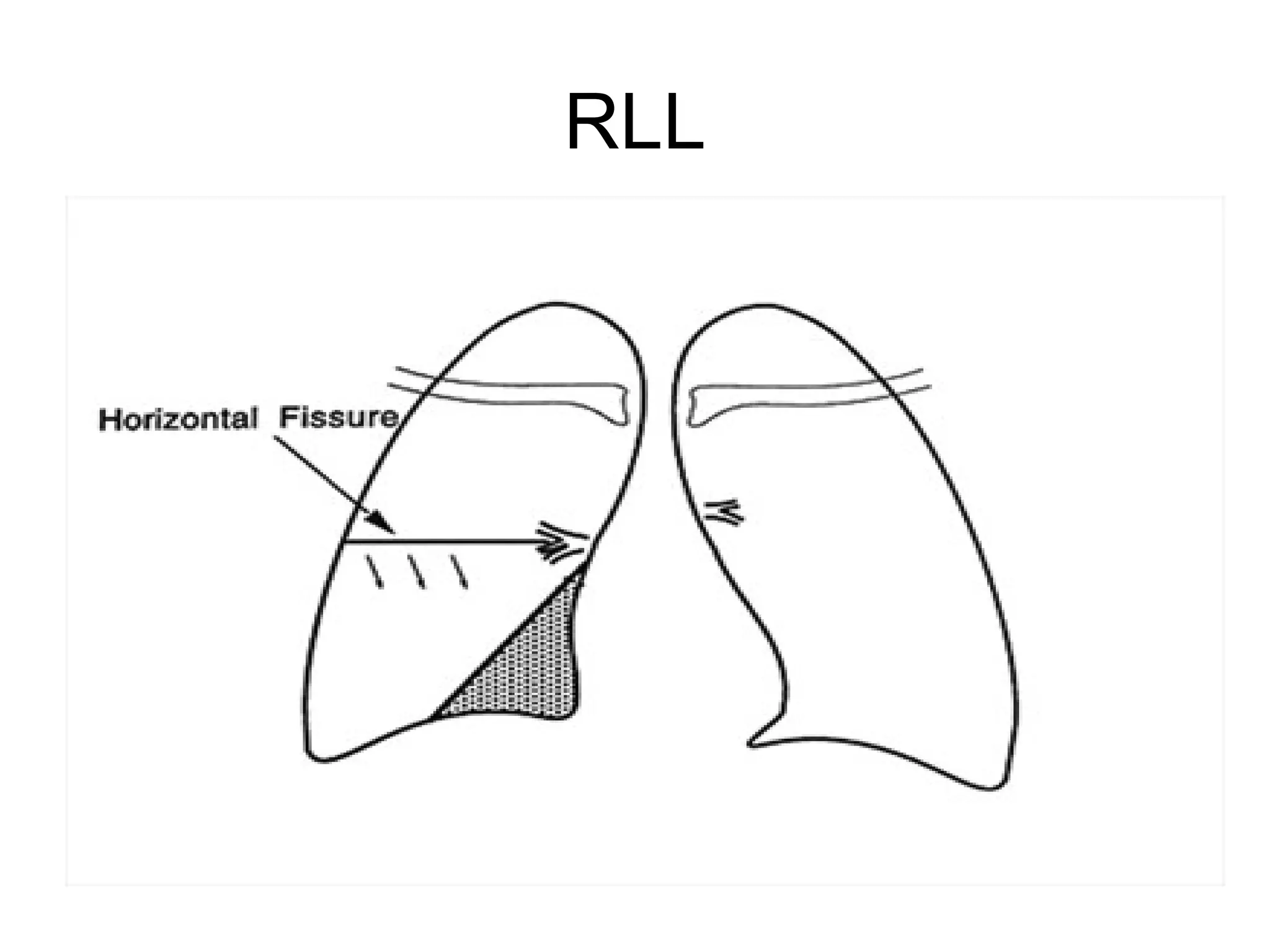 Collapse and consolidation Lung Radiology | PPT