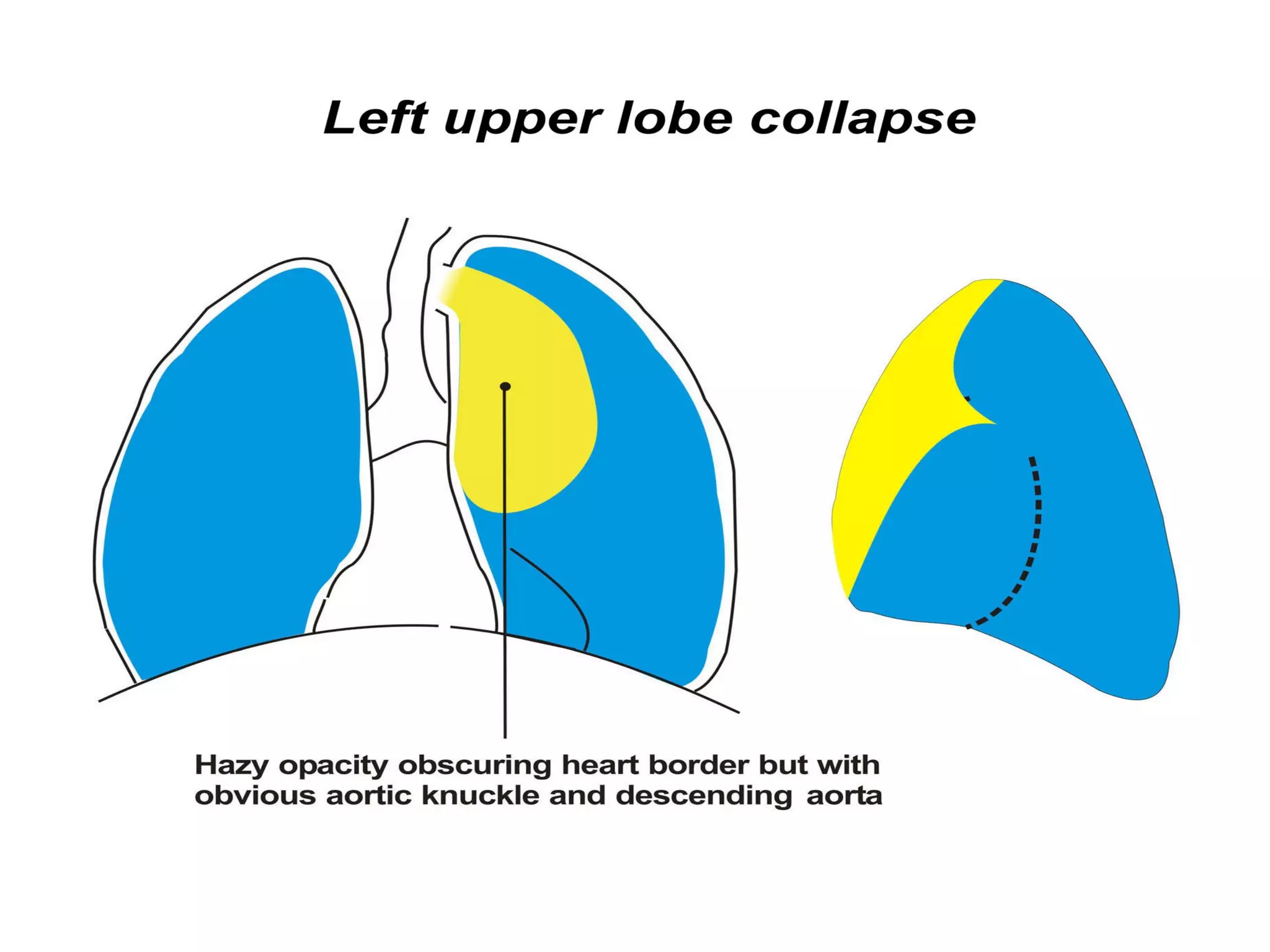 Collapse and consolidation Lung Radiology | PPT