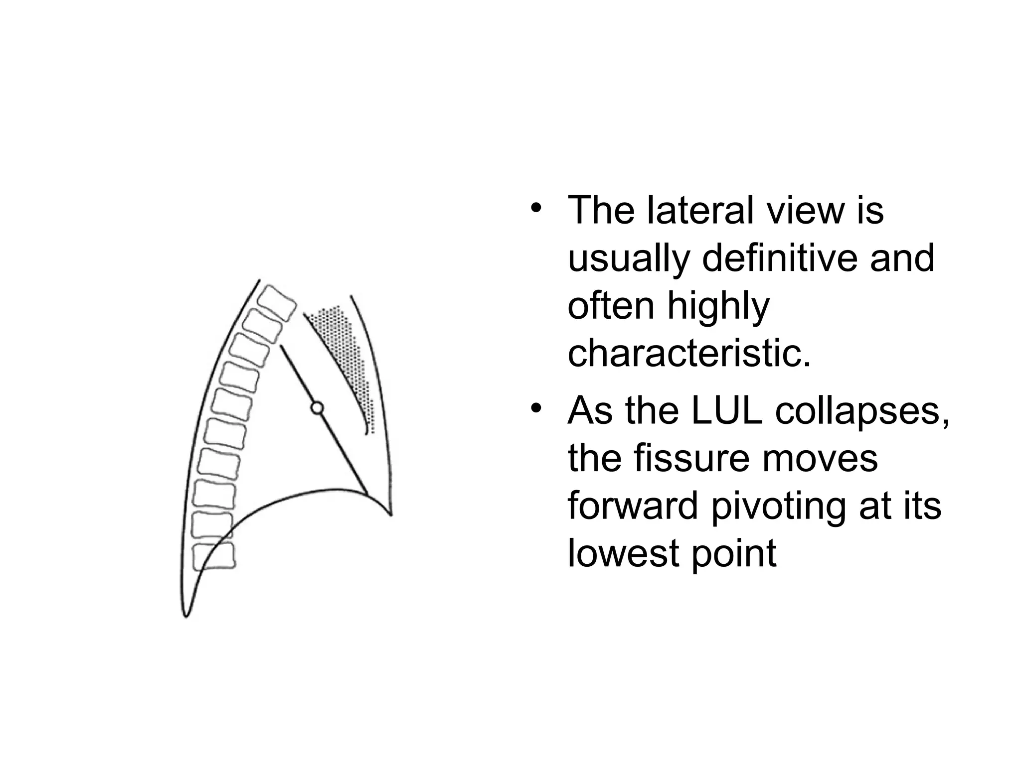 Collapse and consolidation Lung Radiology | PPT
