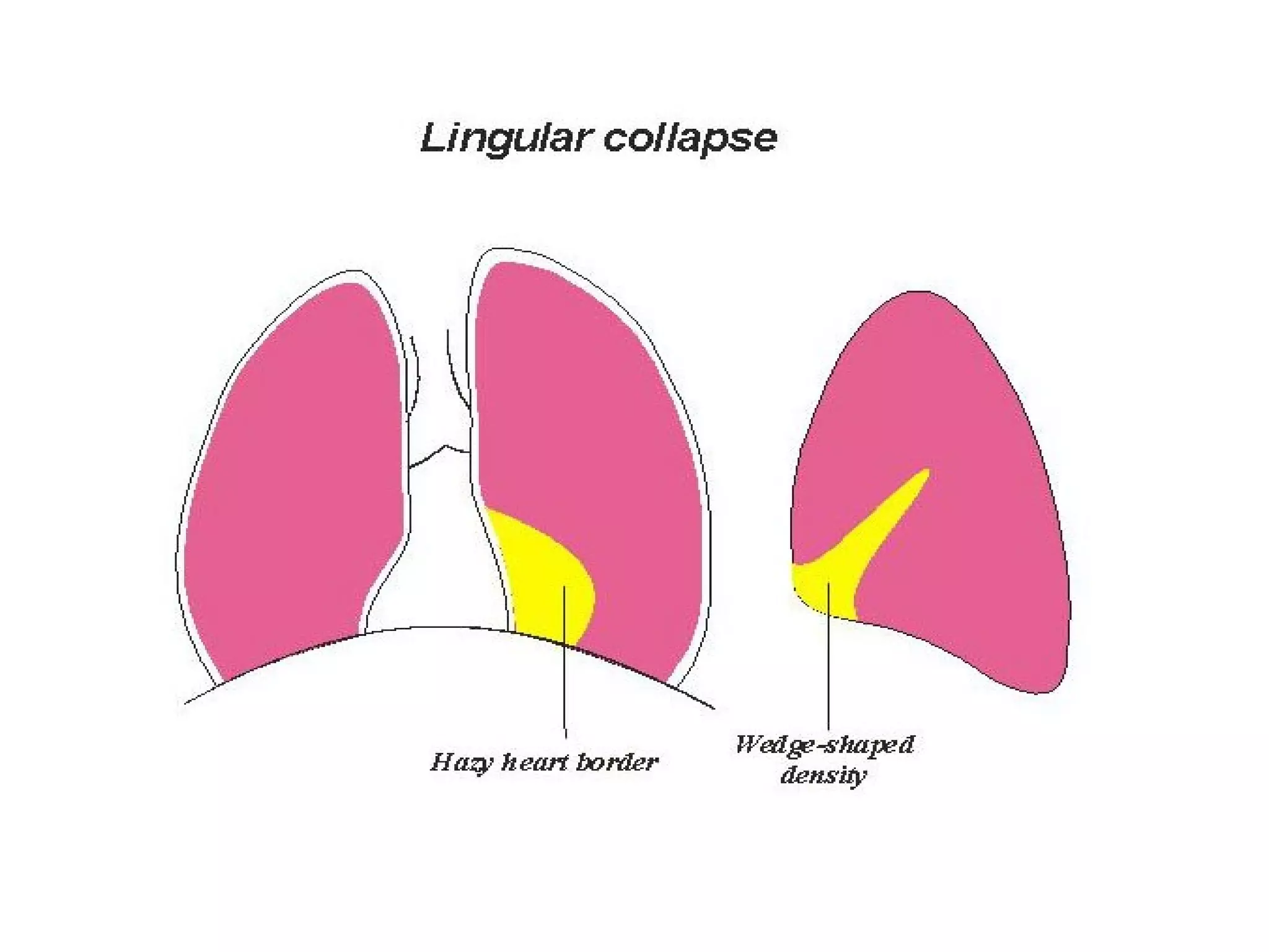 Collapse and consolidation Lung Radiology | PPT