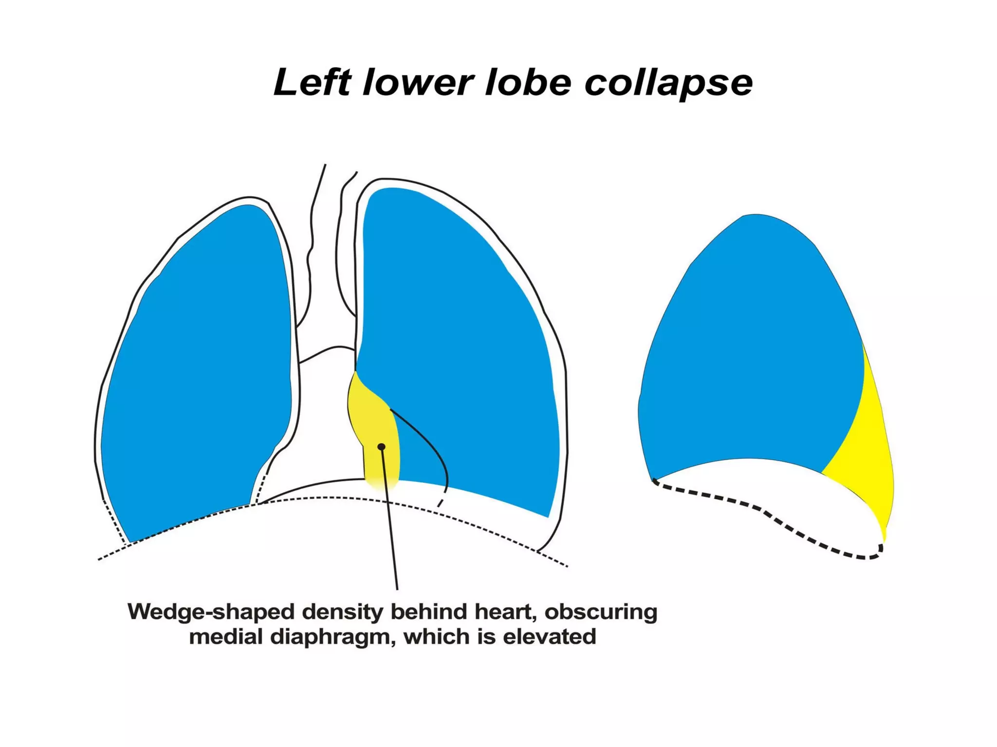 Collapse and consolidation Lung Radiology | PPT