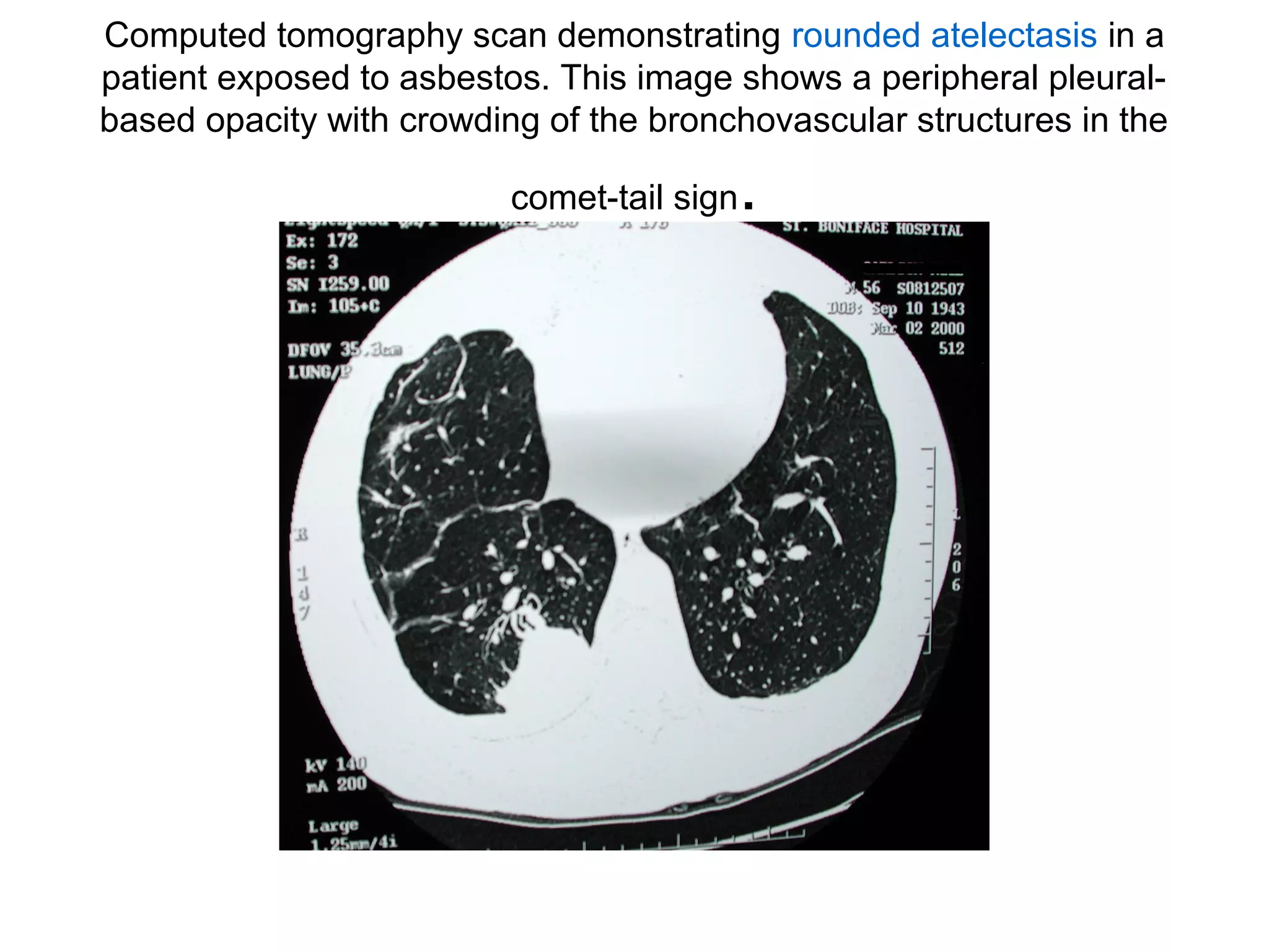 Collapse and consolidation Lung Radiology | PPT