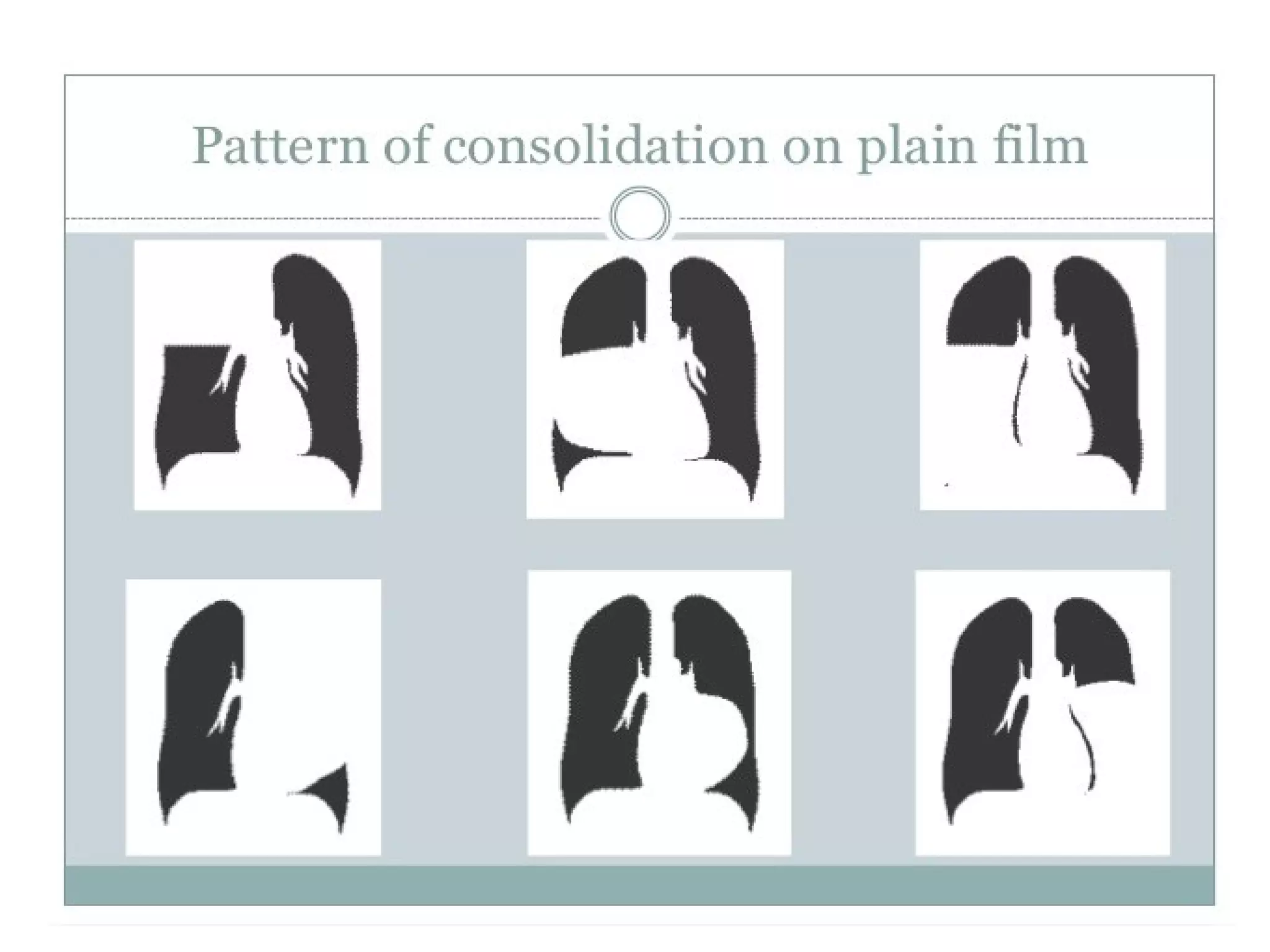 Collapse and consolidation Lung Radiology | PPT