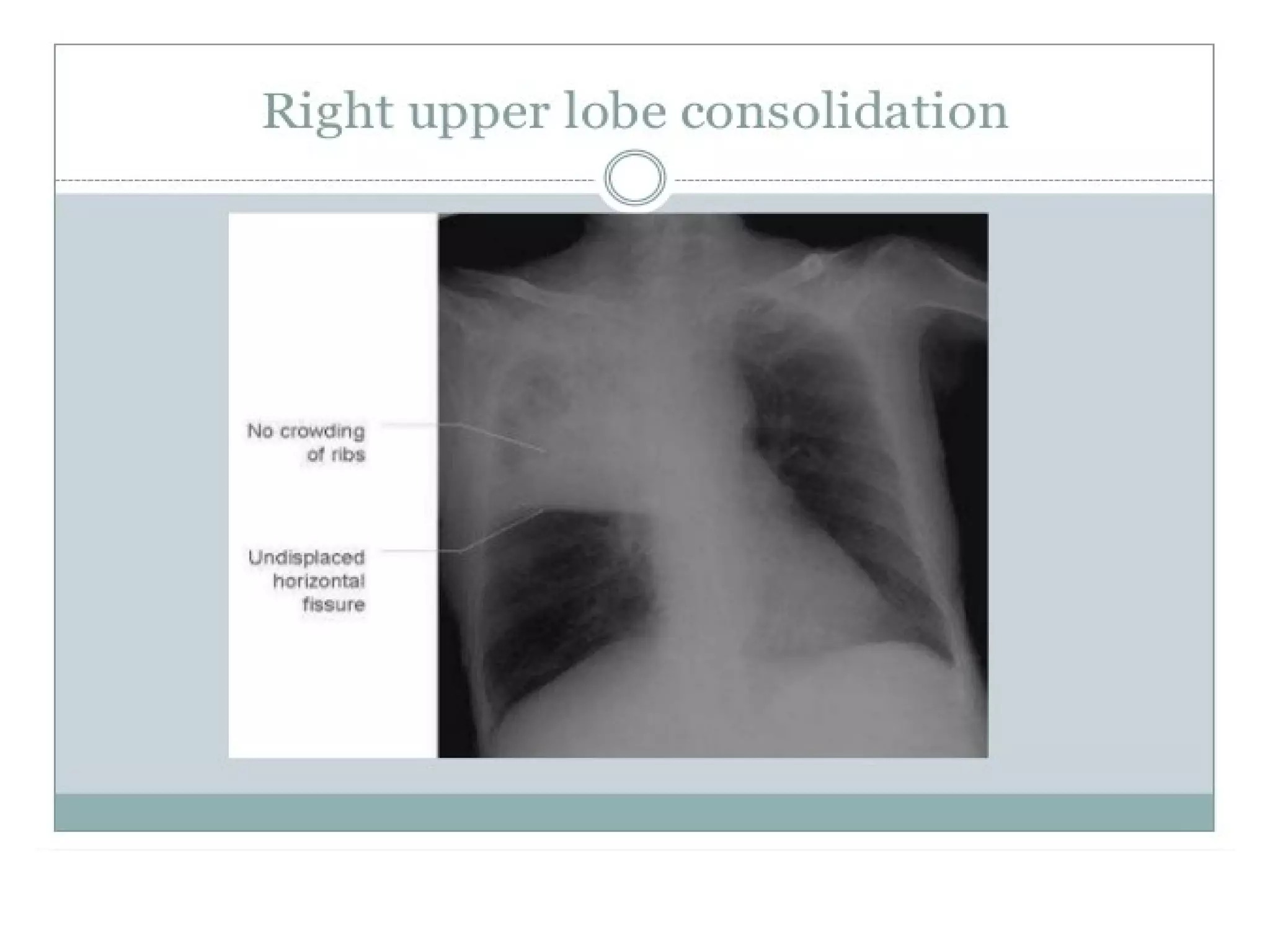 Collapse and consolidation Lung Radiology | PPT