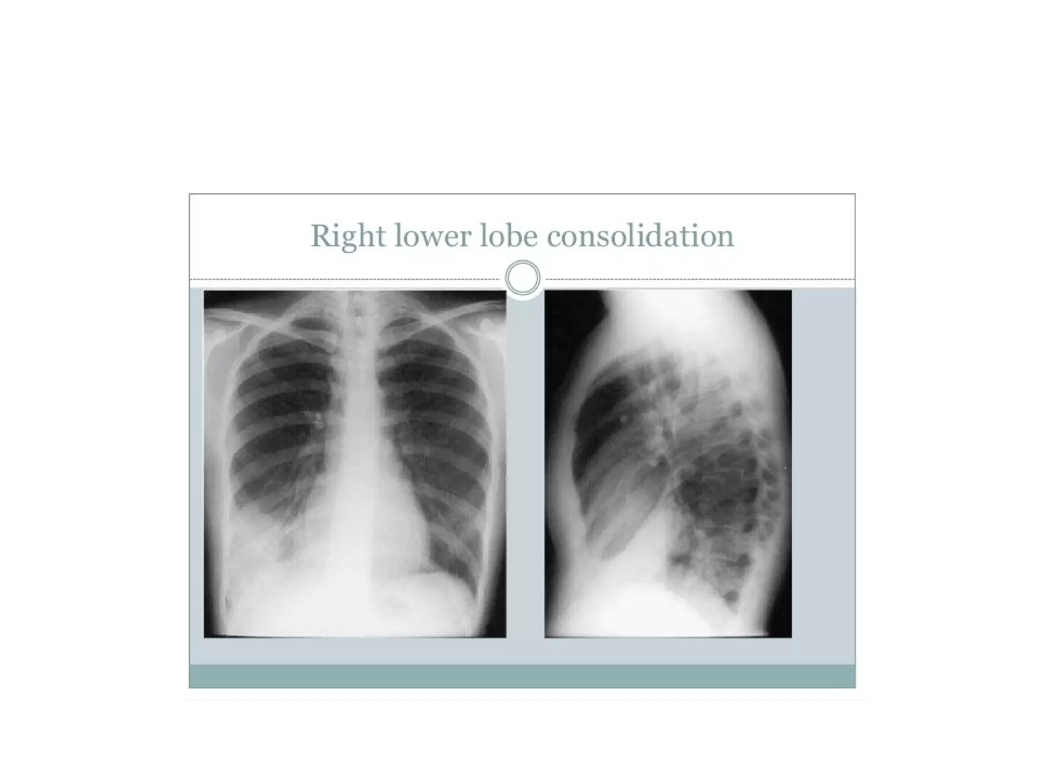 Collapse and consolidation Lung Radiology | PPT