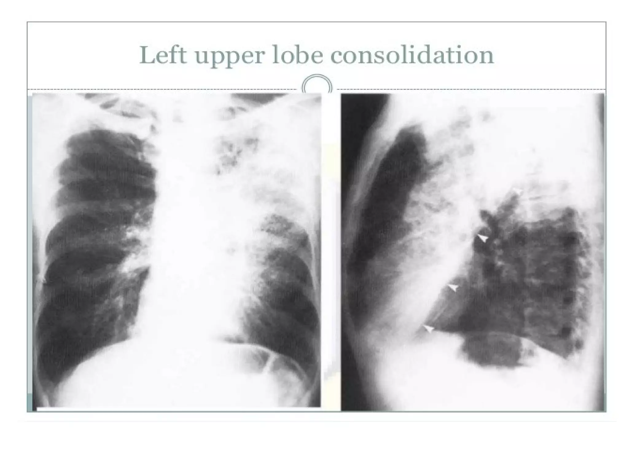 Collapse and consolidation Lung Radiology | PPT