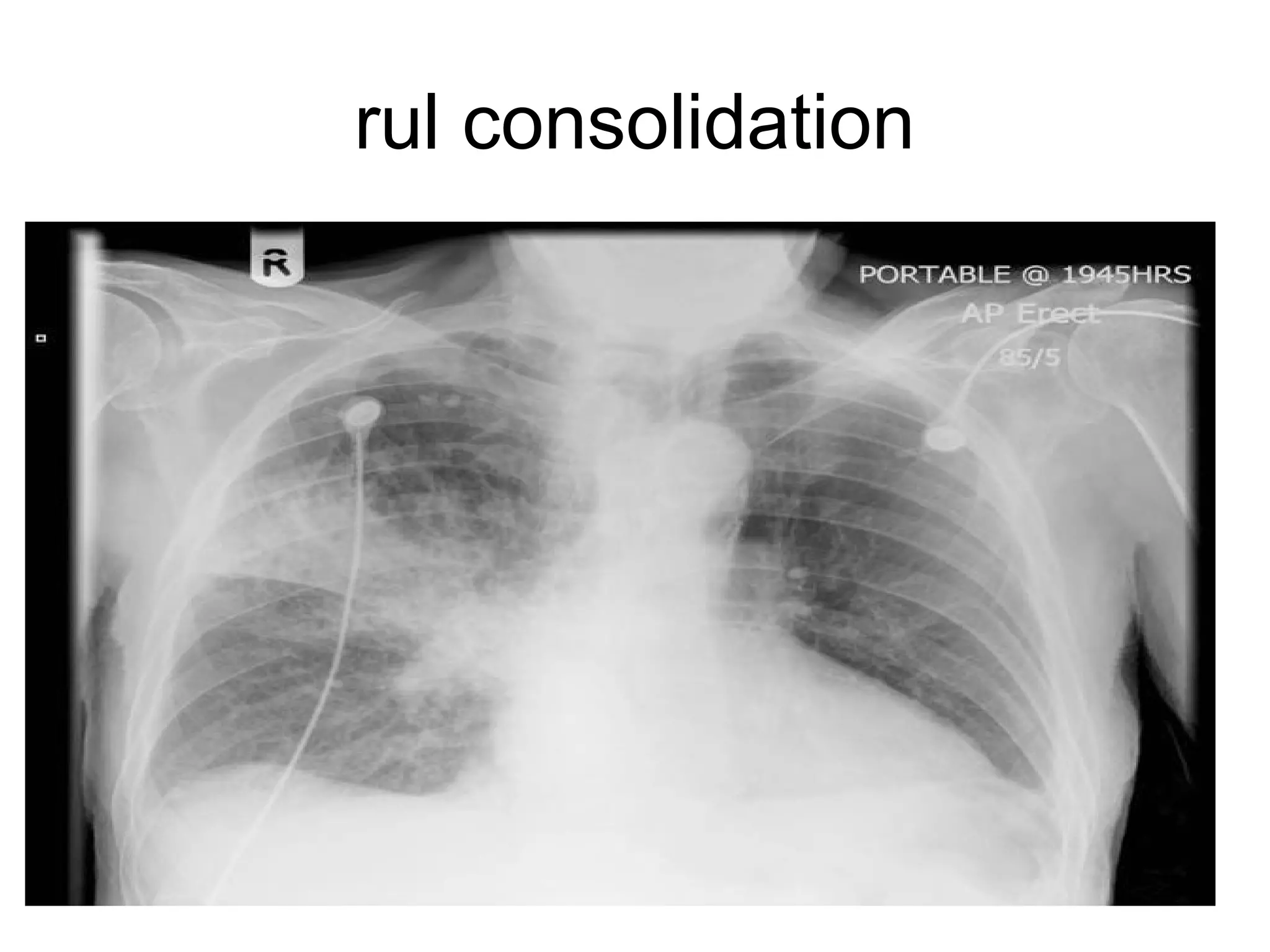 Collapse and consolidation Lung Radiology | PPT