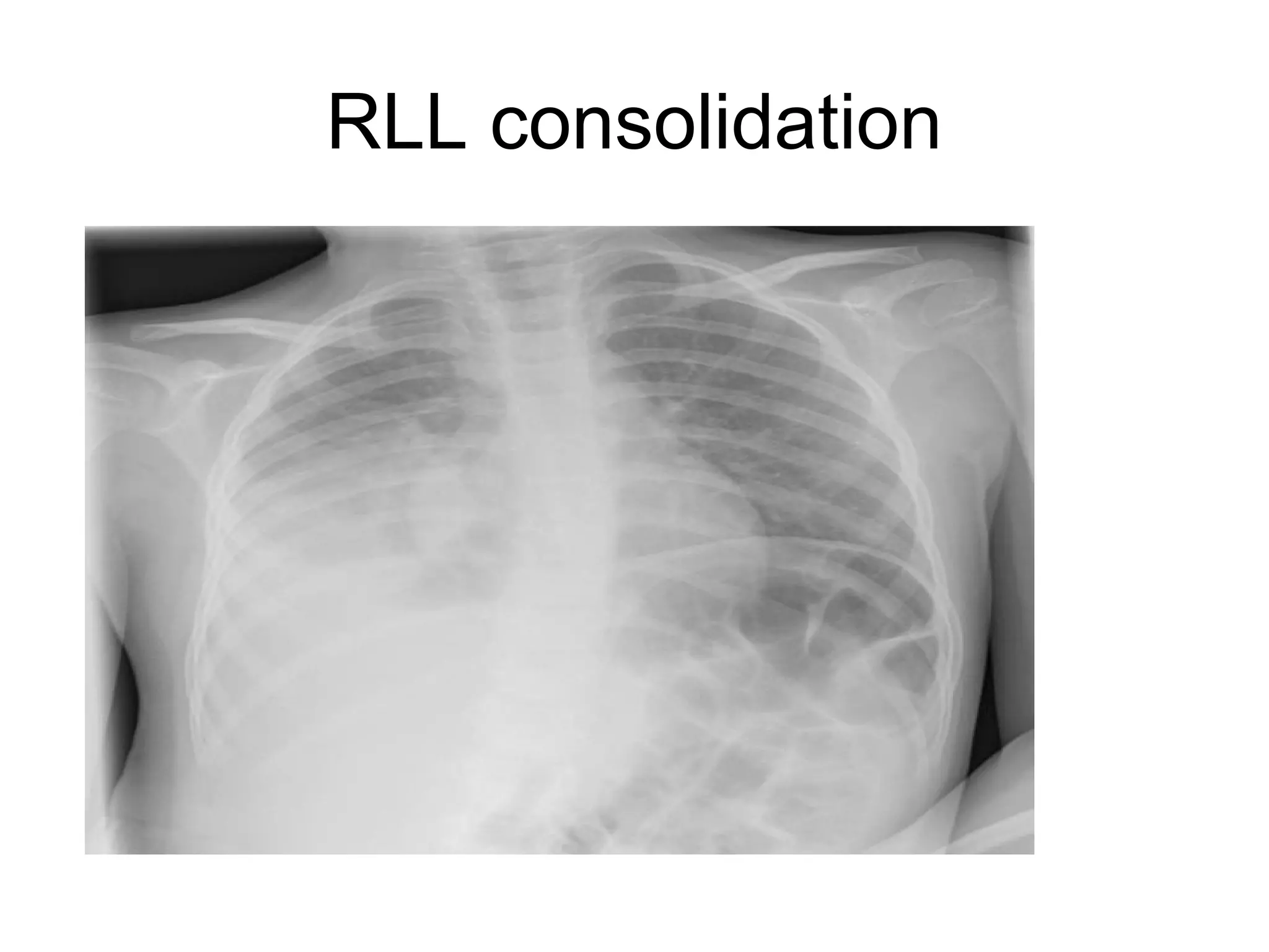 Collapse and consolidation Lung Radiology | PPT