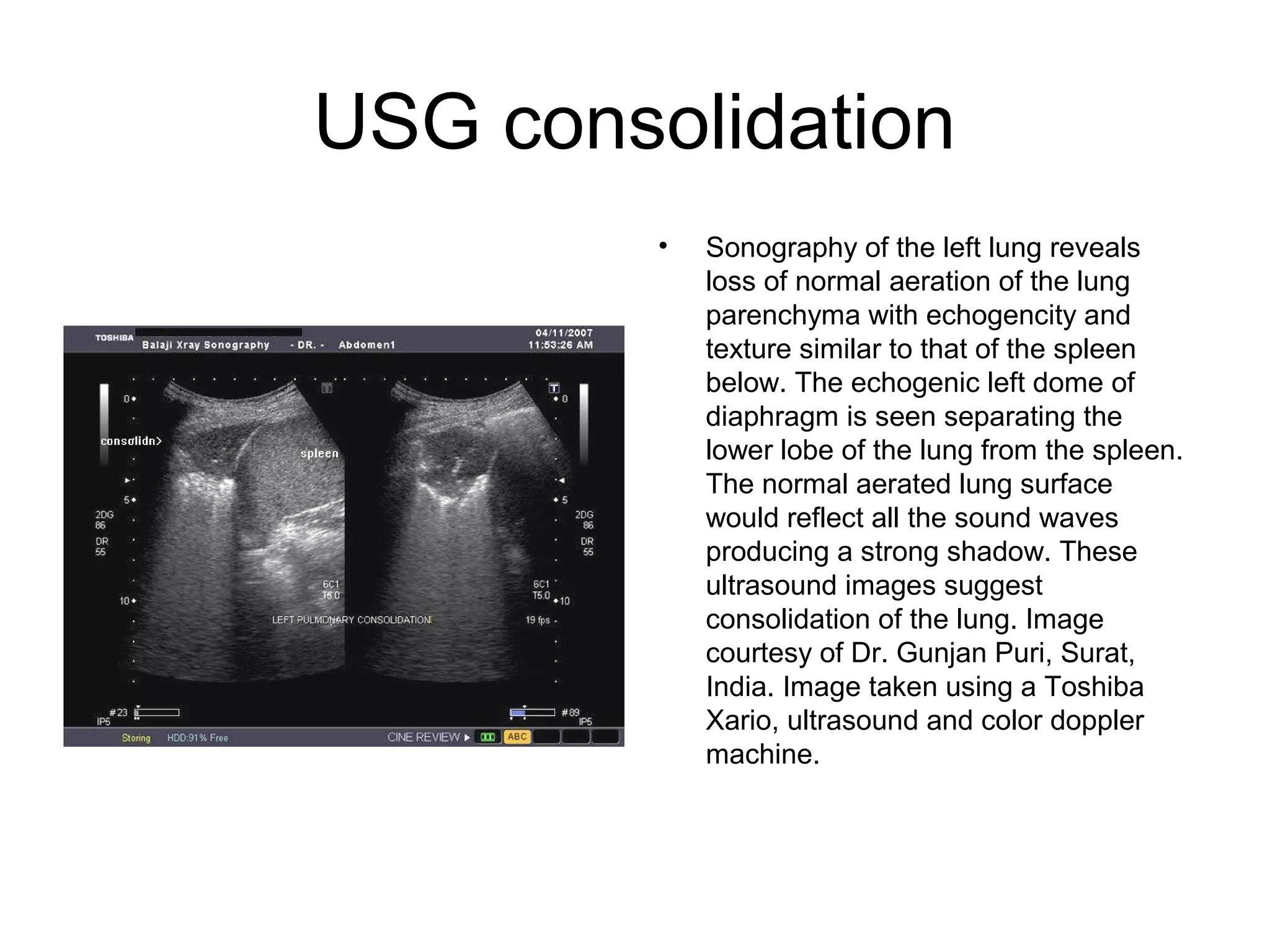 Collapse and consolidation Lung Radiology | PPT