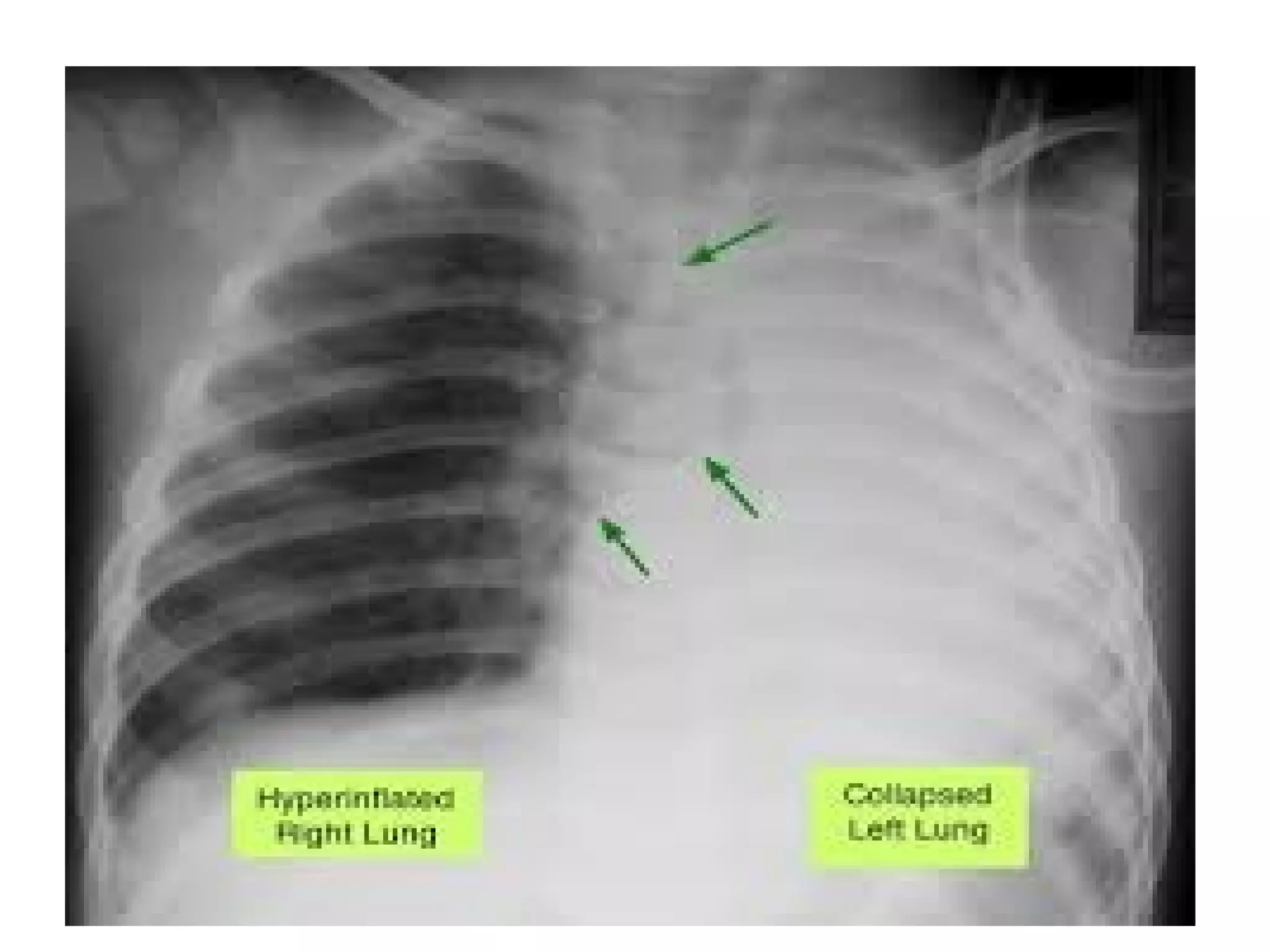 Collapse and consolidation Lung Radiology | PPT