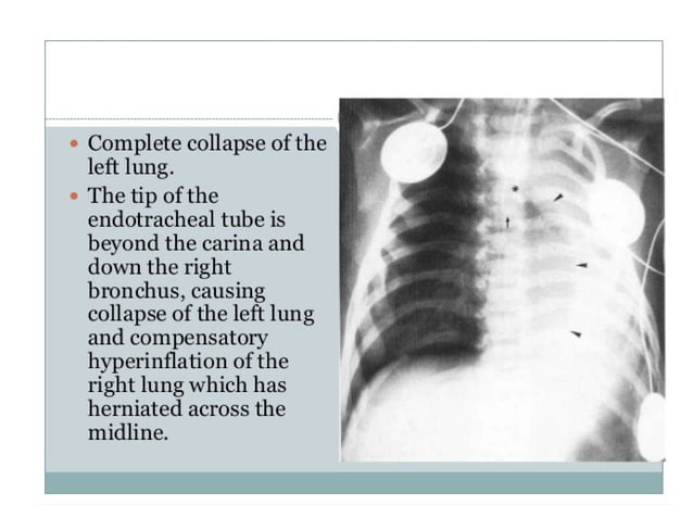 Collapse and consolidation Lung Radiology | PPT