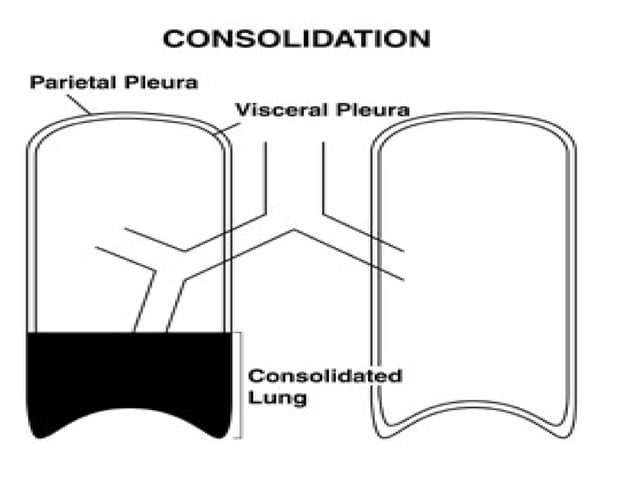 Collapse and consolidation Lung Radiology | PPT