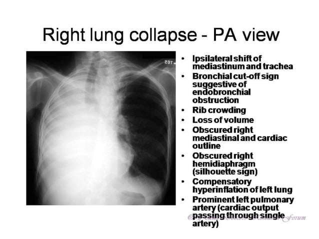Collapse and consolidation Lung Radiology | PPT