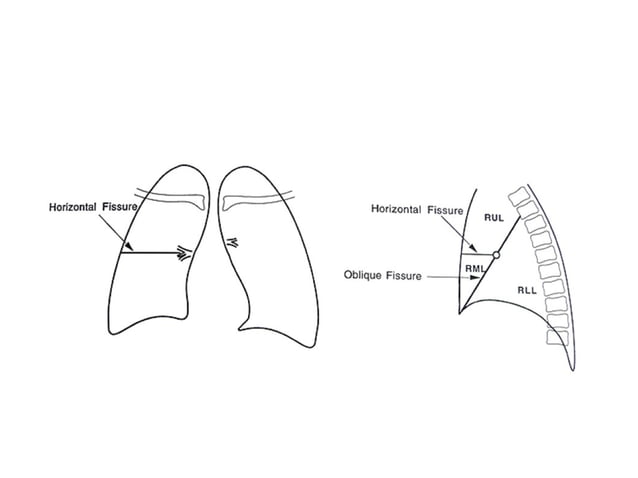 Collapse and consolidation Lung Radiology | PPT
