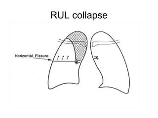 Collapse and consolidation Lung Radiology | PPT
