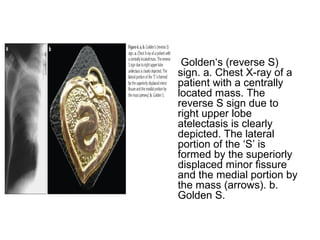 Collapse and consolidation Lung Radiology | PPT