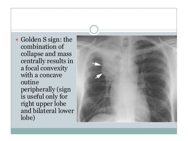 Collapse and consolidation Lung Radiology | PPT