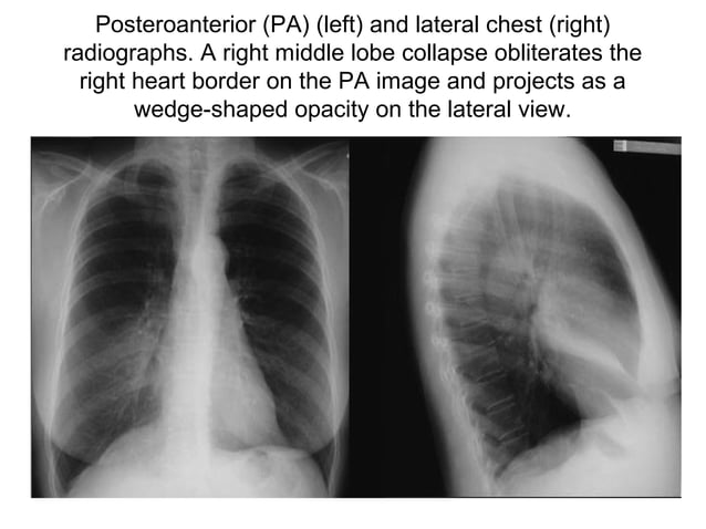 Collapse and consolidation Lung Radiology | PPT