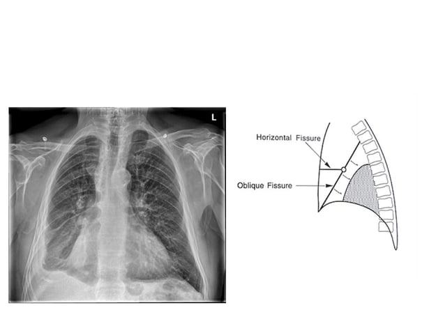 Collapse and consolidation Lung Radiology | PPT